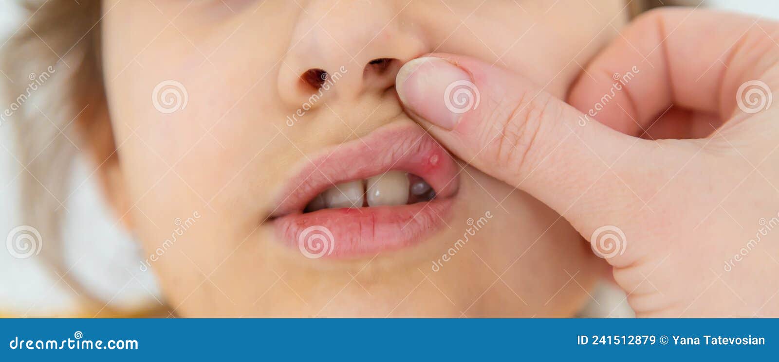 The Child Has Stomatitis on the Lip. Selective Focus Stock Image ...