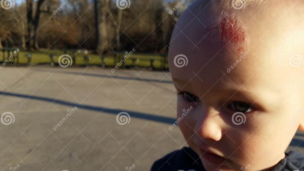 Child with Head Injury stock image. Image of care, good - 51510103