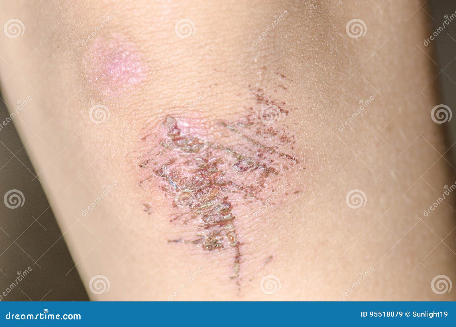 Child Hurt His Knee, an Abrasion on the Pavement Stock Image - Image of ...