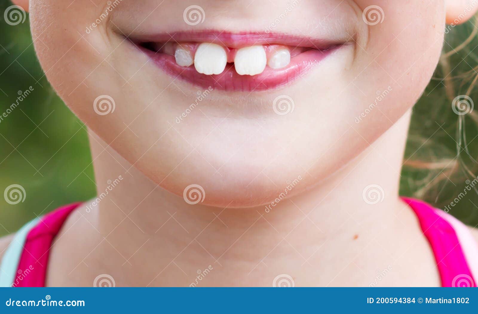 Child with malocclusion stock photo. Image of young - 200594384