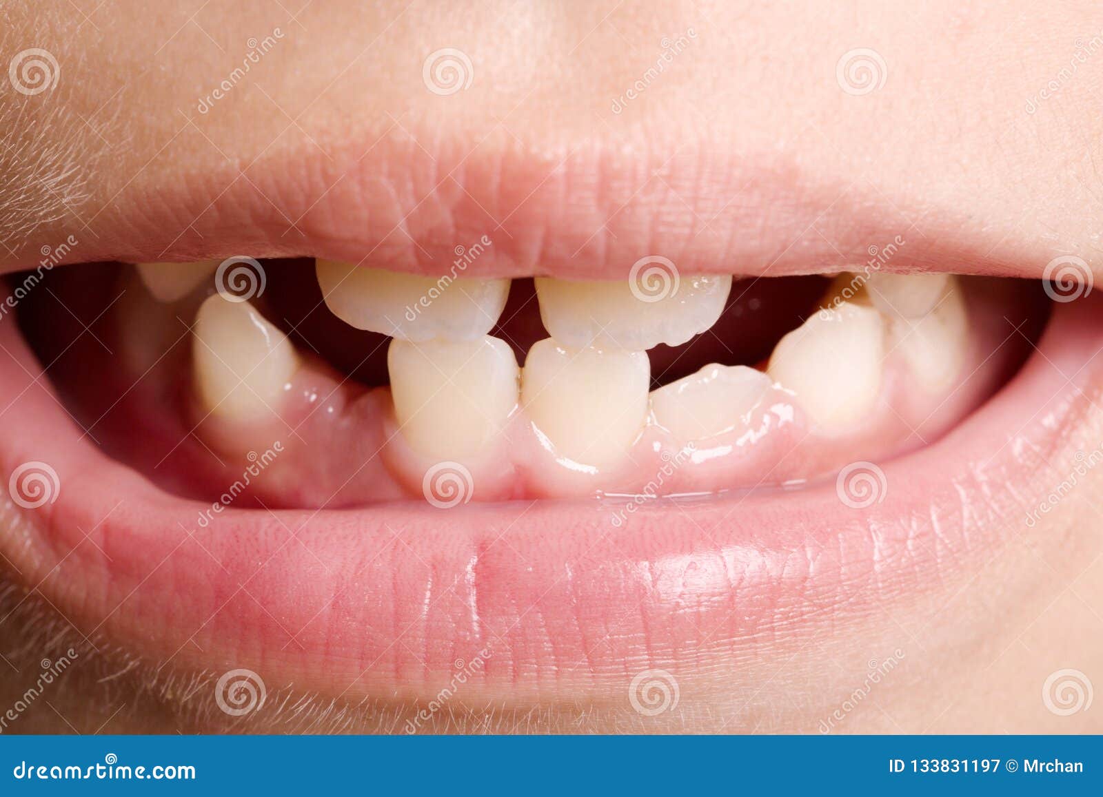 Child missing front teeth stock image. Image of hole - 133831197