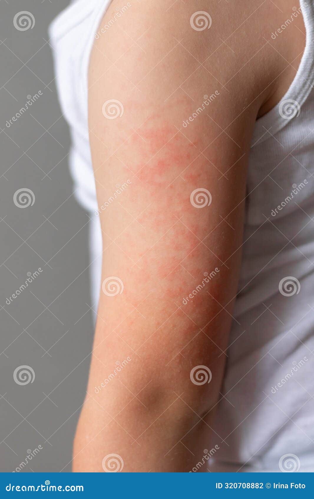 Child& X27;s Arm with Red Rash Stock Photo - Image of skin, pediatric ...