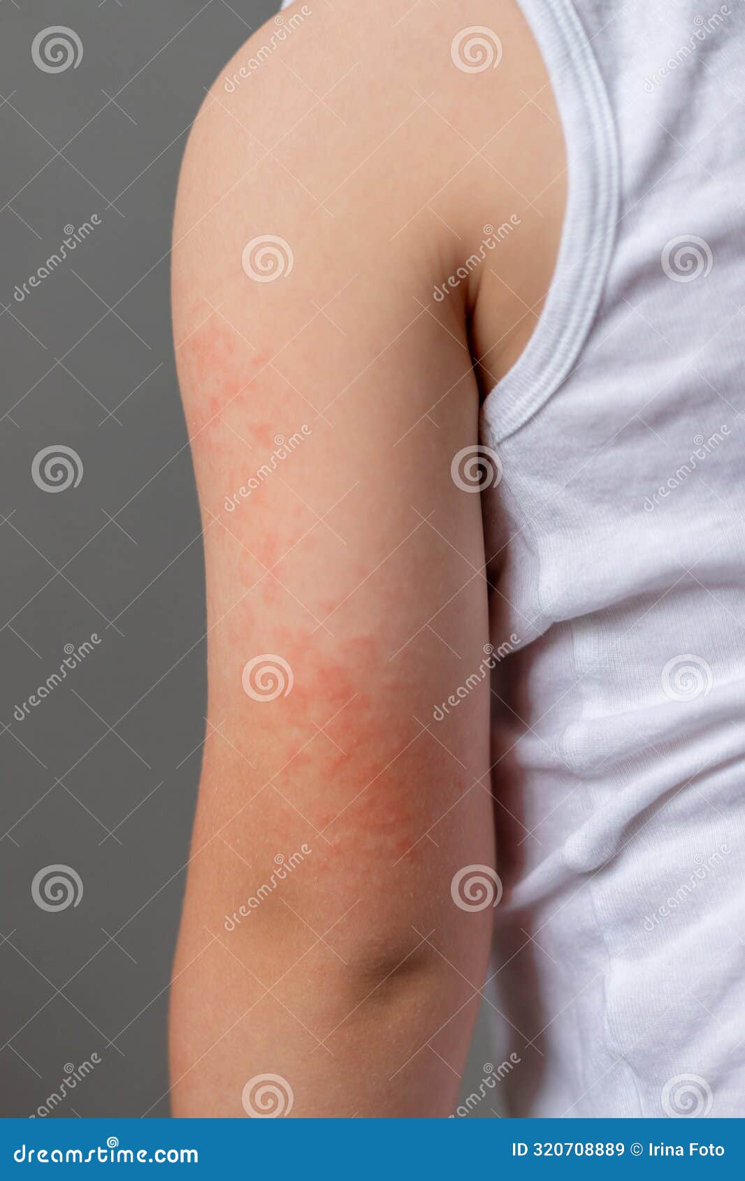 Child& X27;s Arm with Red Rash Stock Image - Image of childhood, eczema ...