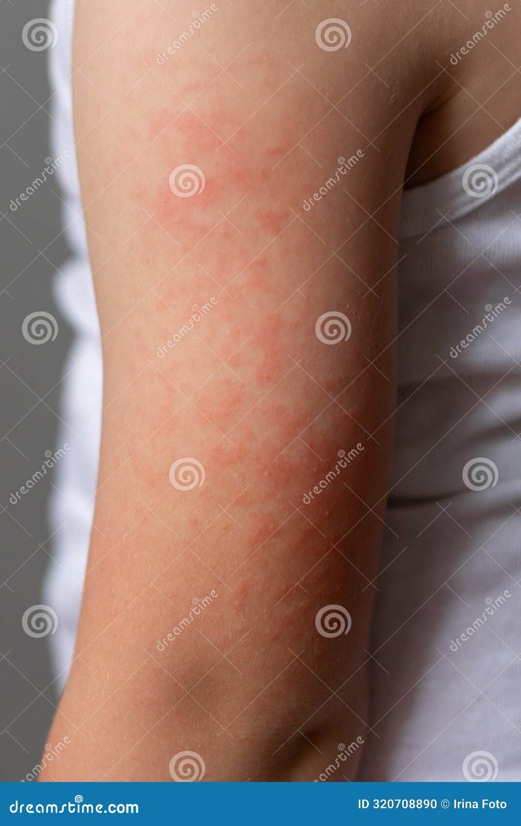 Child& X27;s Arm with Red Rash Stock Photo - Image of skin, outbreak ...