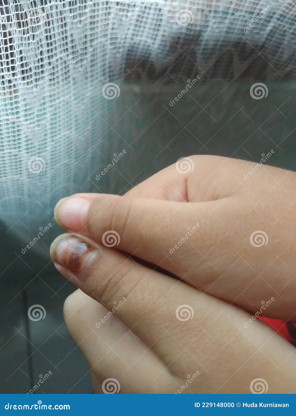 The Child& X27;s Finger Nail is Broken because it is Stuck in the Door ...