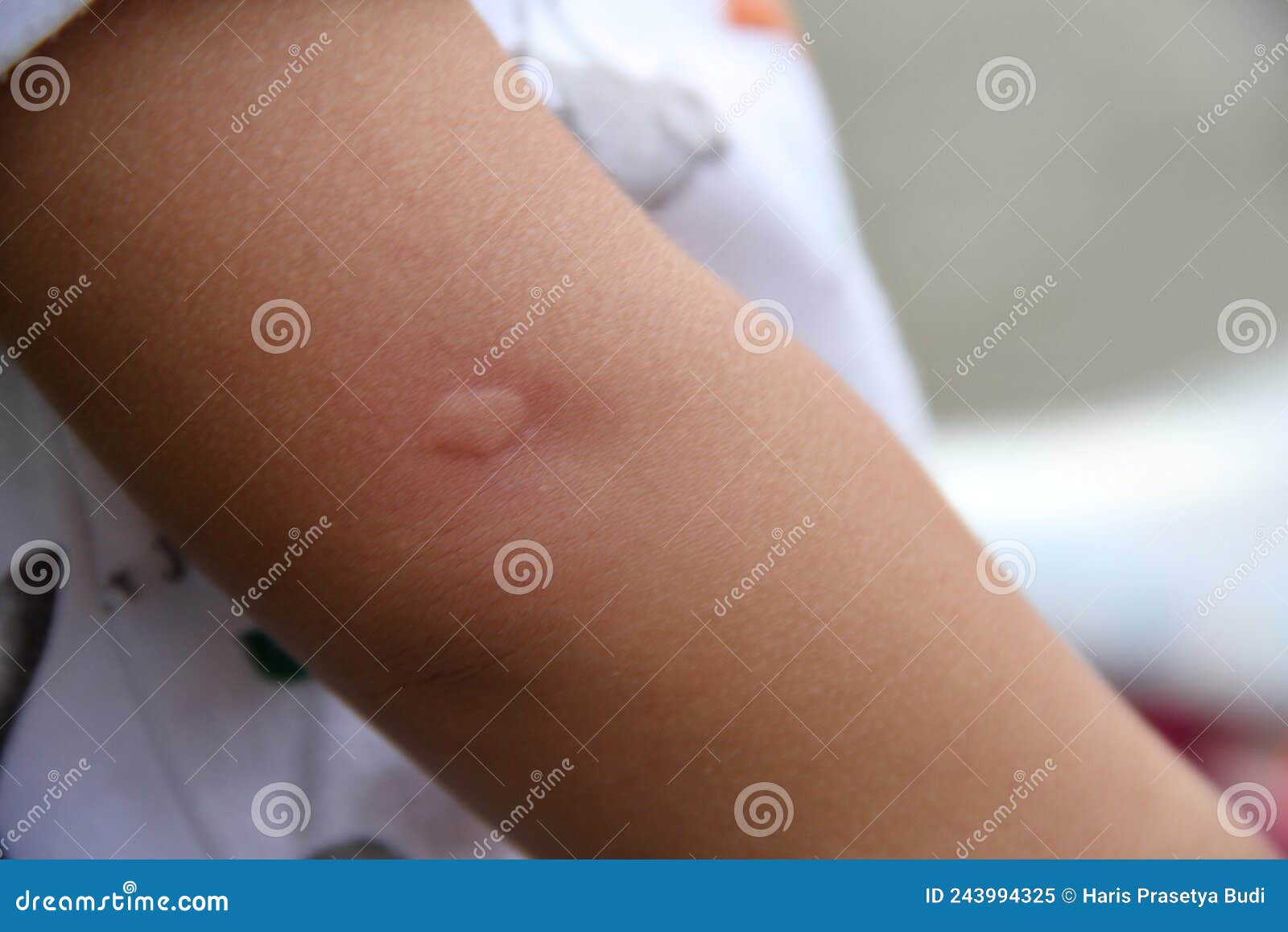 A Child& X27;s Hand Has a Sore from a Mosquito Bite. Stock Image ...
