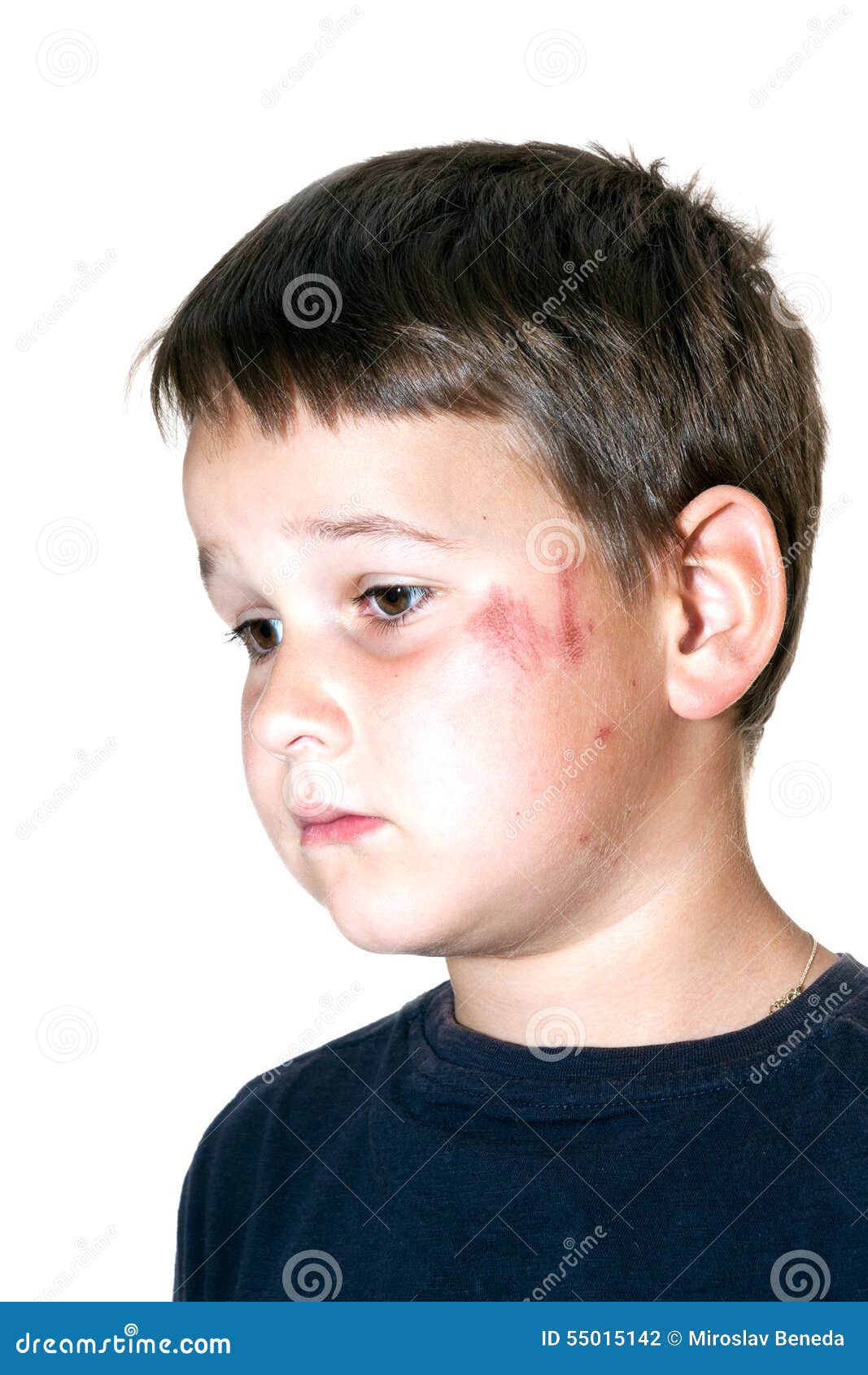 Child with a scraped face stock photo. Image of human - 55015142