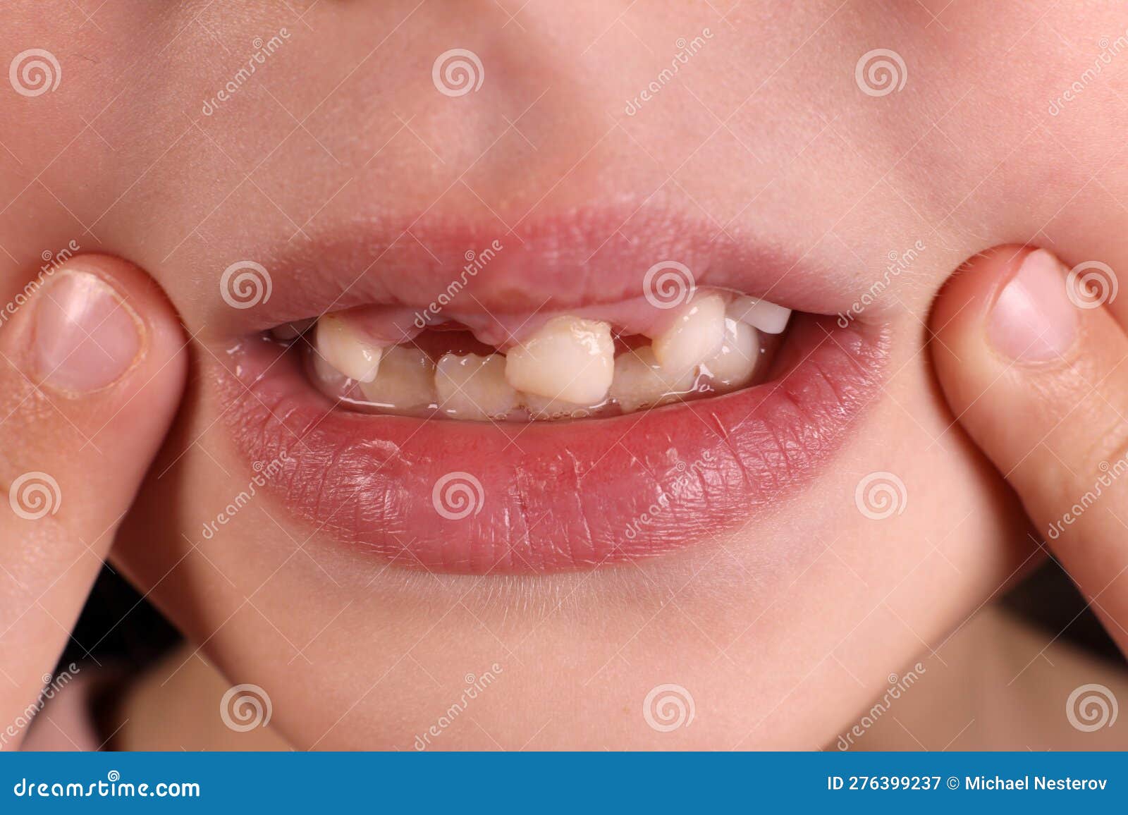 Child Showing Lost Baby Teeth Stock Image - Image of girl, clean: 276399237