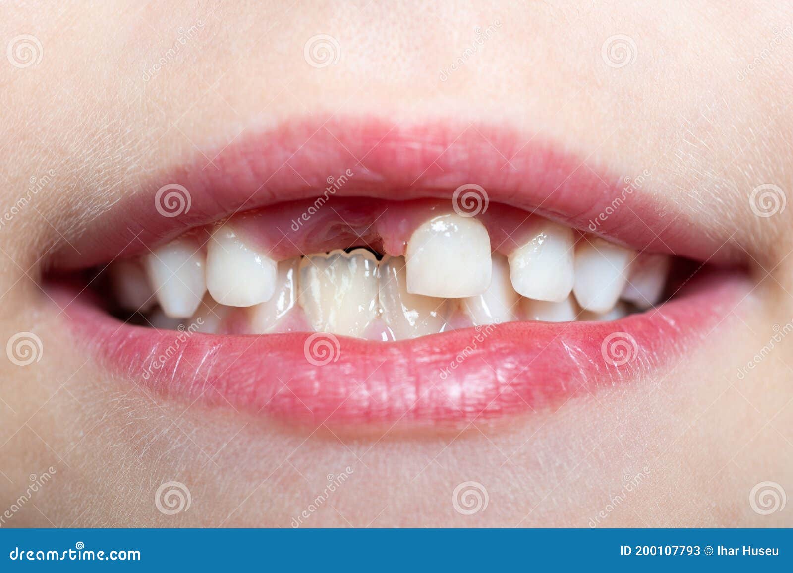 The Child Shows the First Lost Tooth Stock Image - Image of mouth ...
