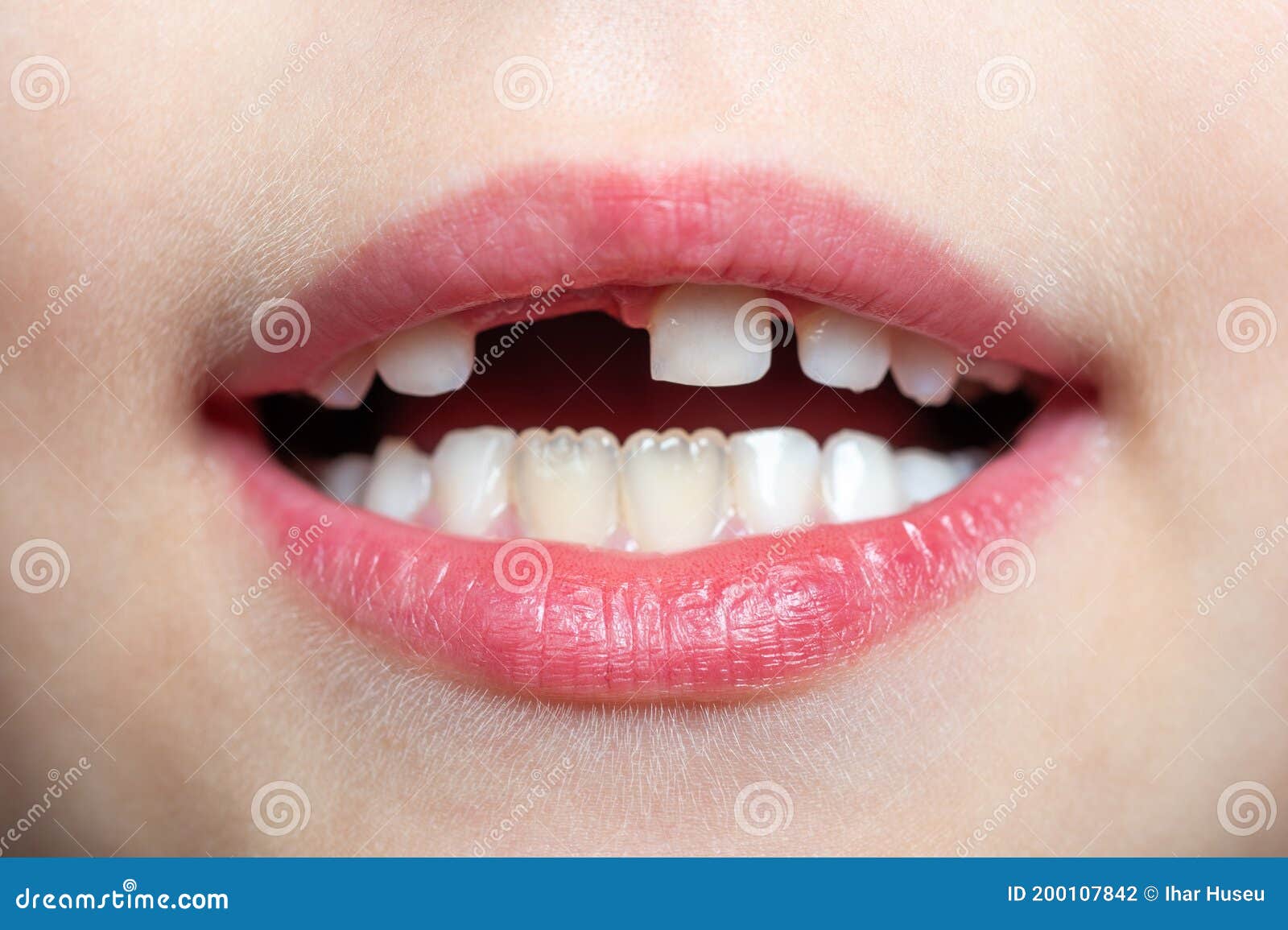 The Child Shows the First Lost Tooth Stock Photo - Image of toothless ...