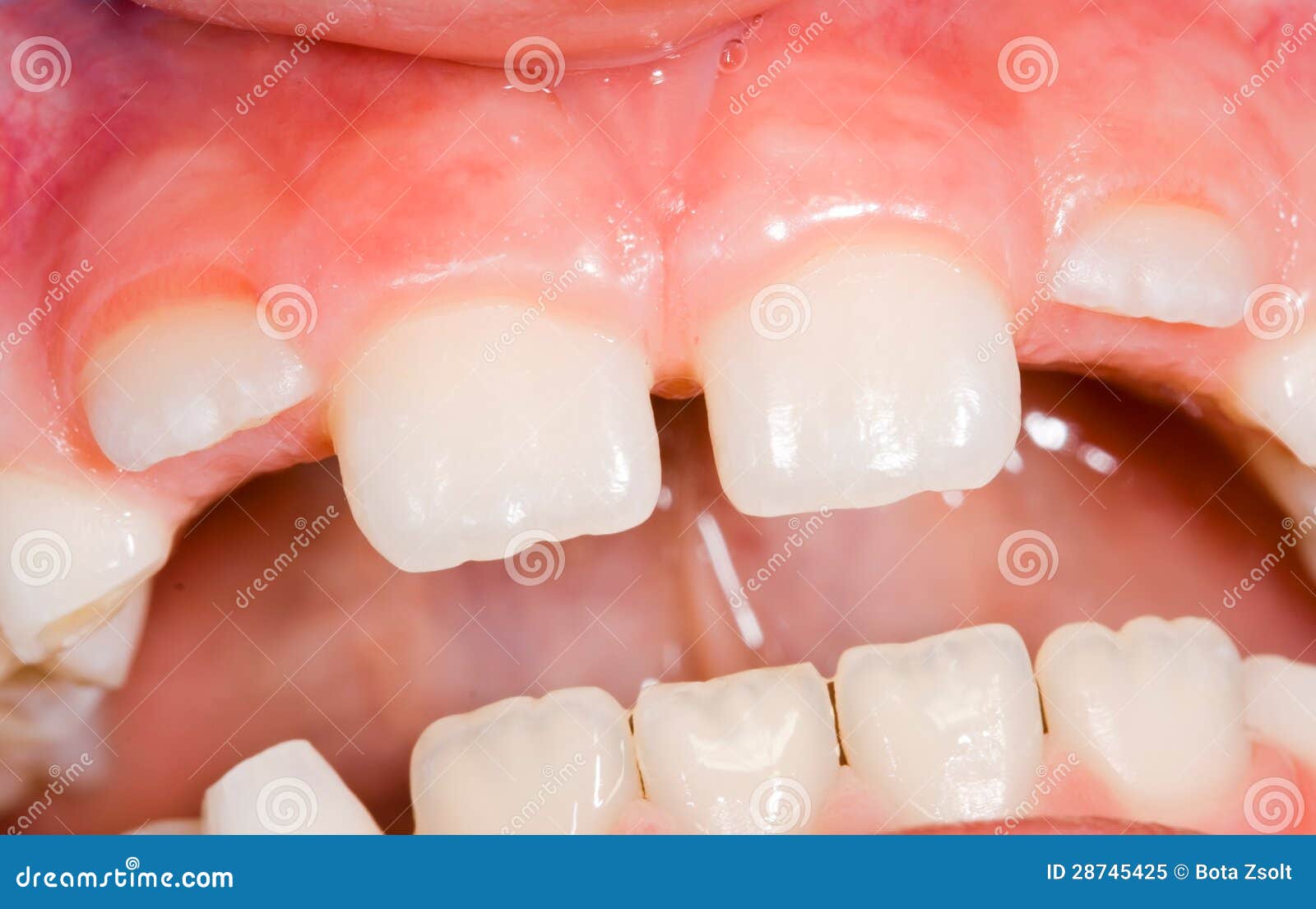 Child tooth eruption stock image. Image of health, macro - 28745425
