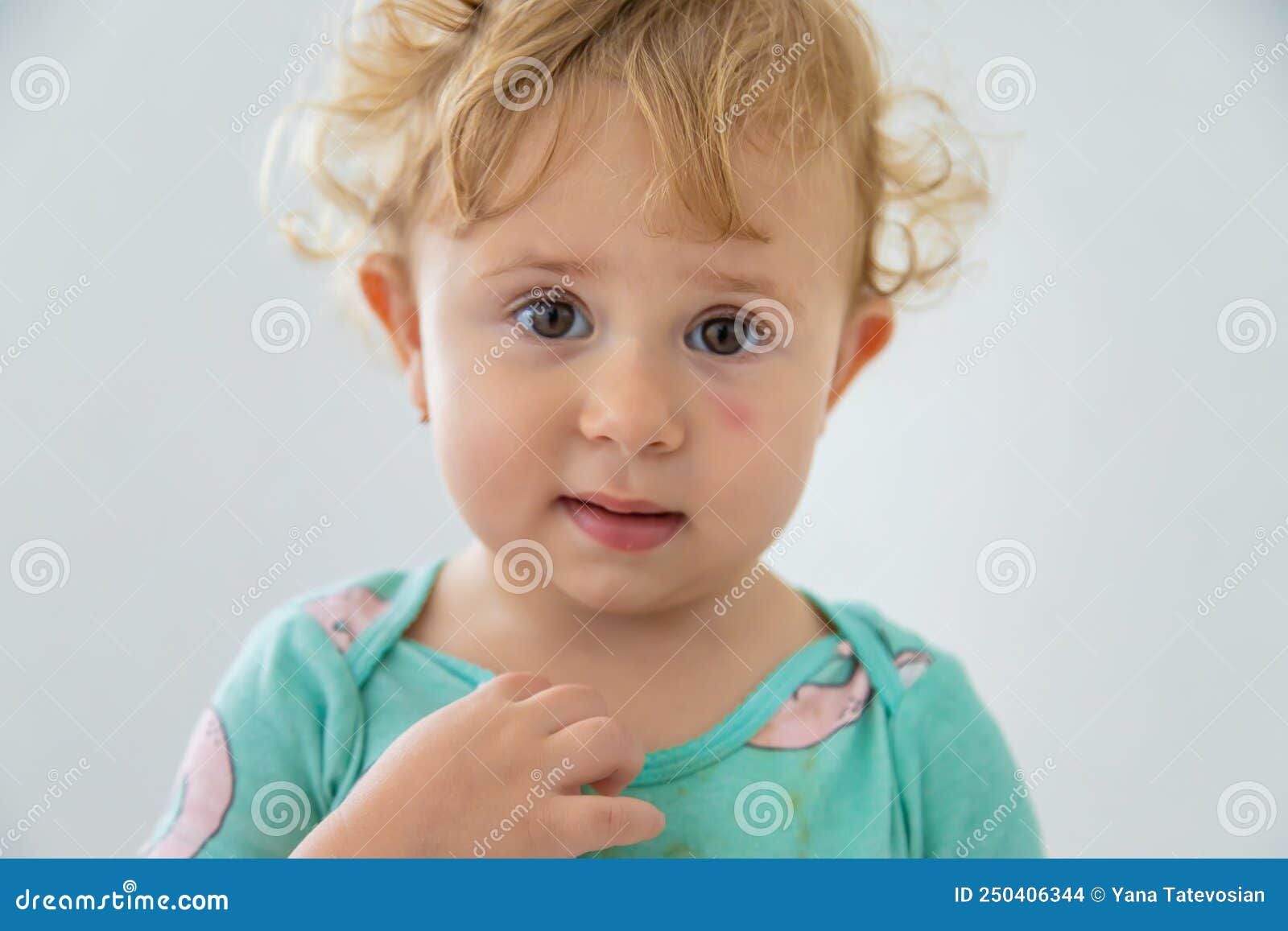The Child Was Bitten on the Face by a Mosquito. Selective Focus Stock ...