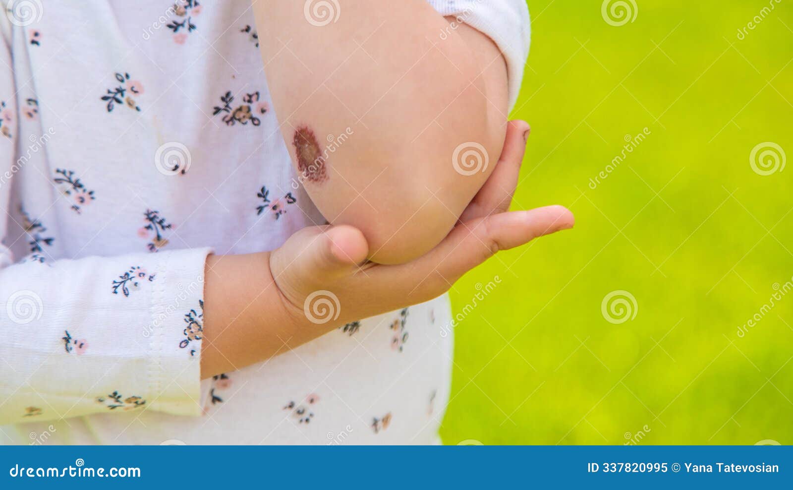 Child Wound on Hand. Selective Focus Stock Image - Image of body ...