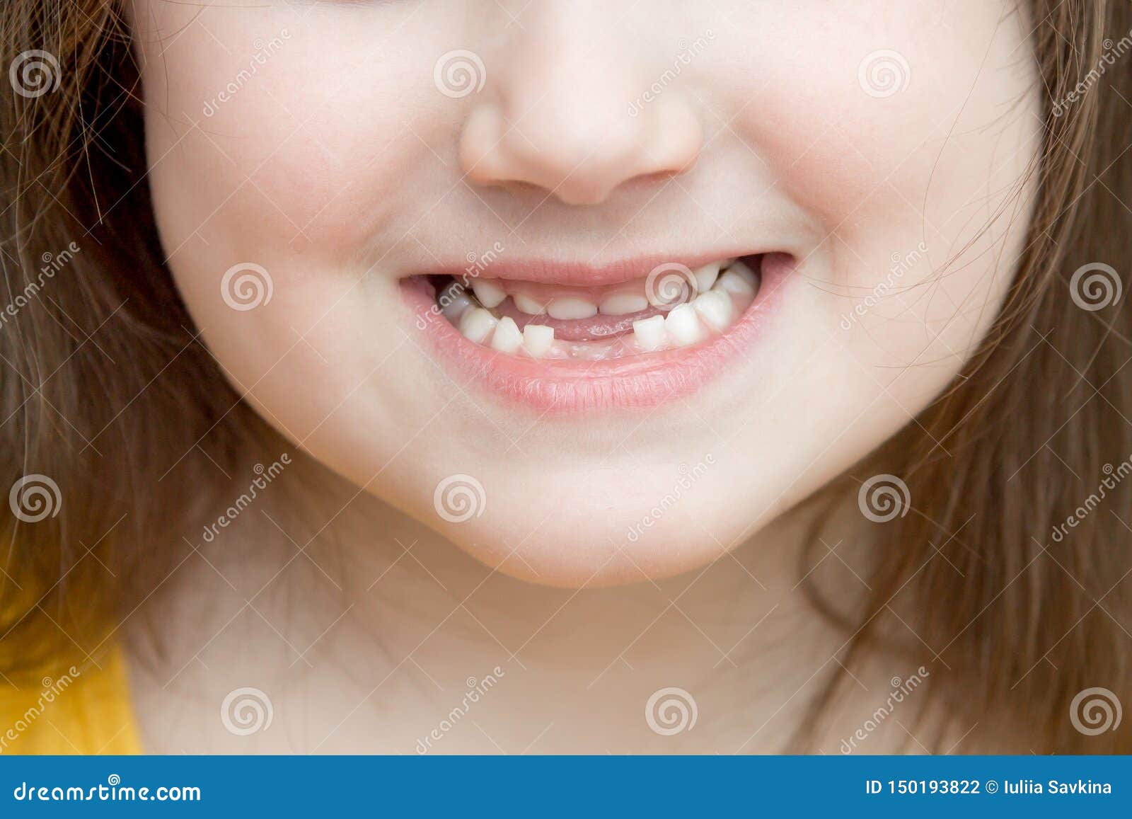 Childish Face Lower Part with Missing Front Lower Milk Teeth in a ...