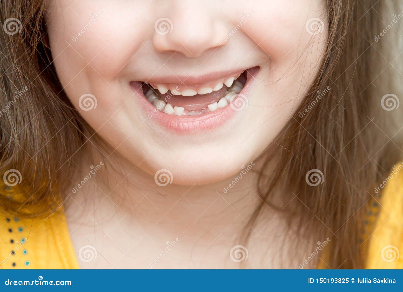 Childish Face Lower Part with Missing Front Lower Milk Teeth in a ...