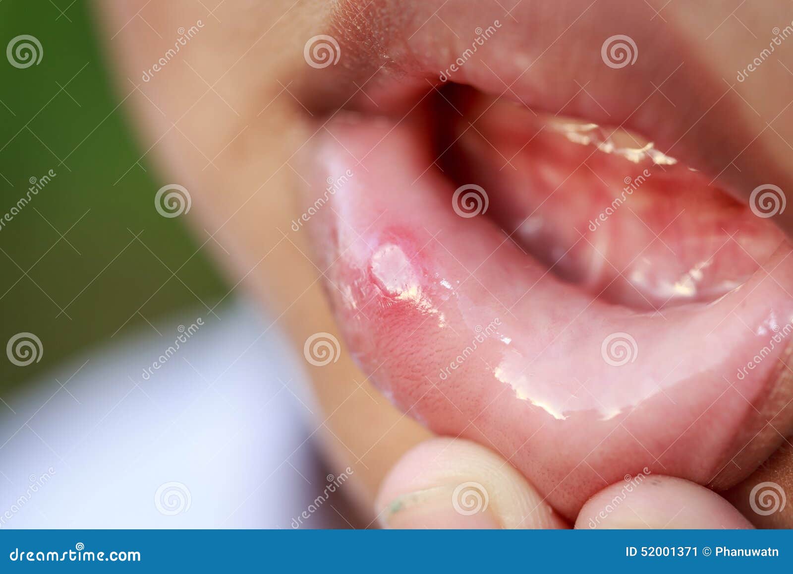 Children with Aphtha on Lip Stock Image - Image of close, discomfort ...