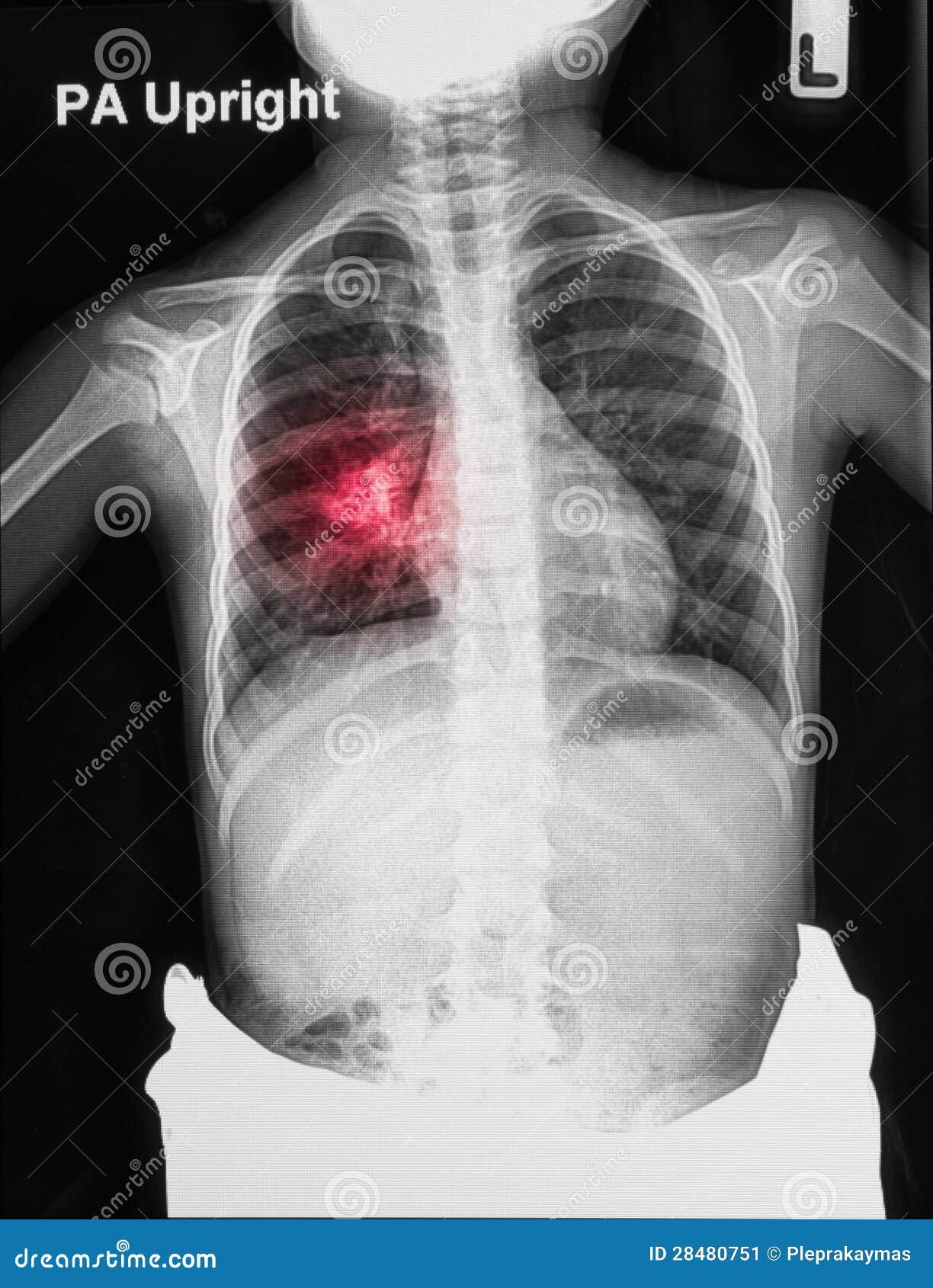 Children chest X-rays stock image. Image of body, abdomen - 28480751