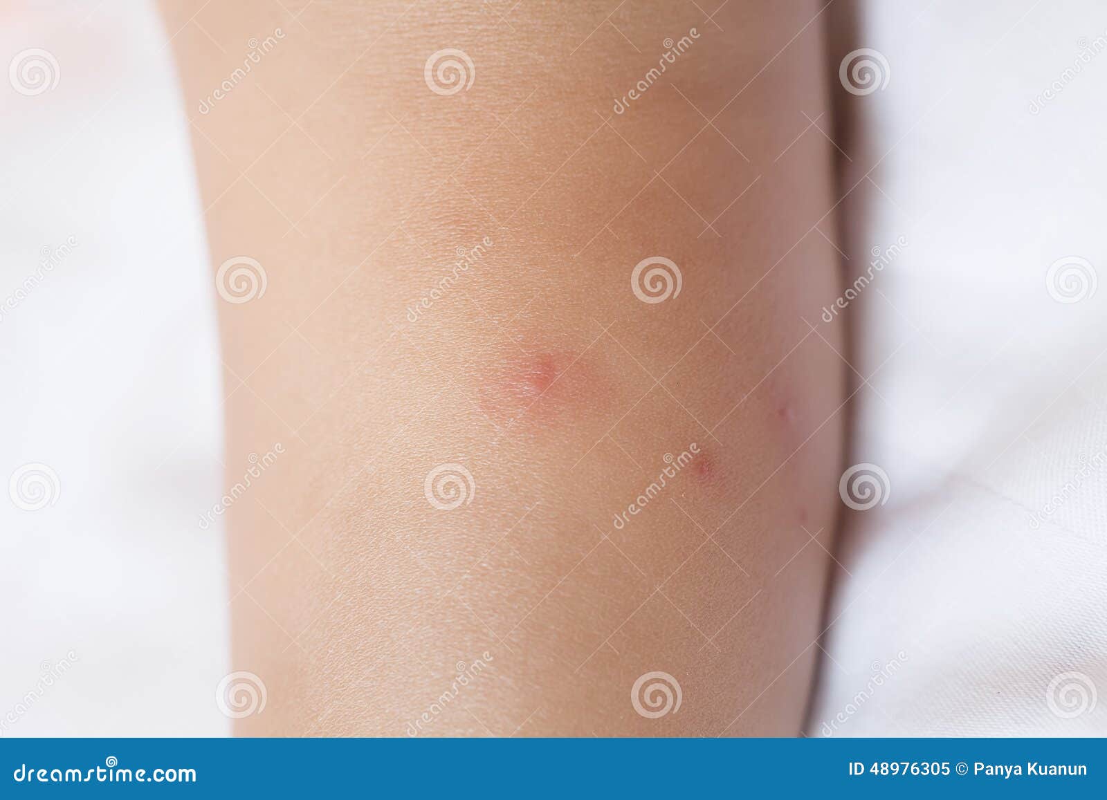 Children Mosquito Bites on the Legs Stock Image - Image of sick, sting ...