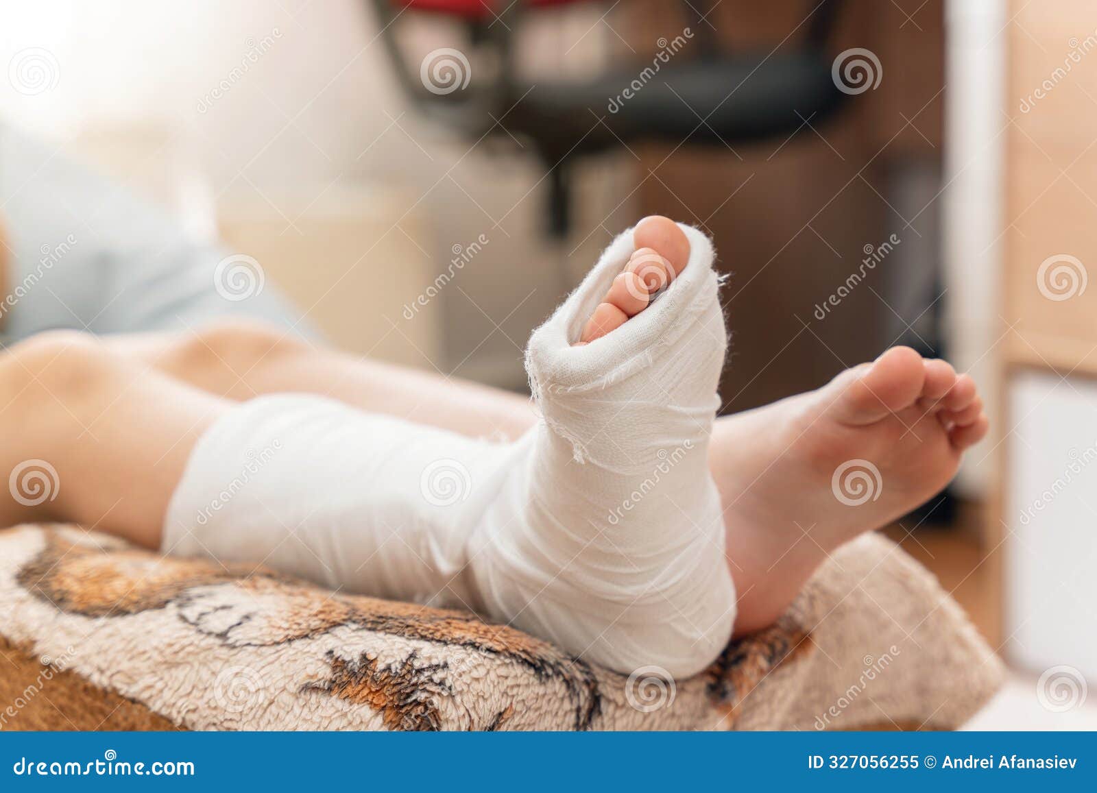 Children S Legs, One Leg is Broken and in a Cast Stock Image - Image of ...