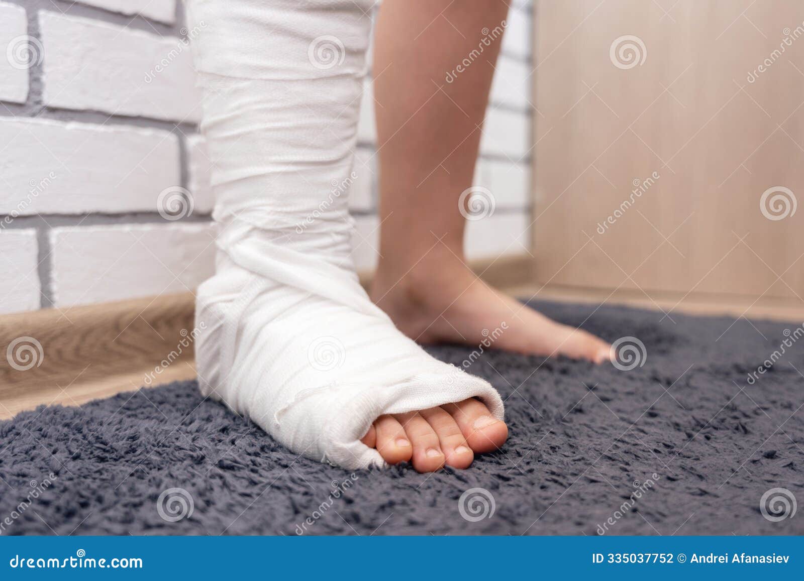 Children S Legs, One Leg is Broken and in a Cast Stock Photo - Image of ...