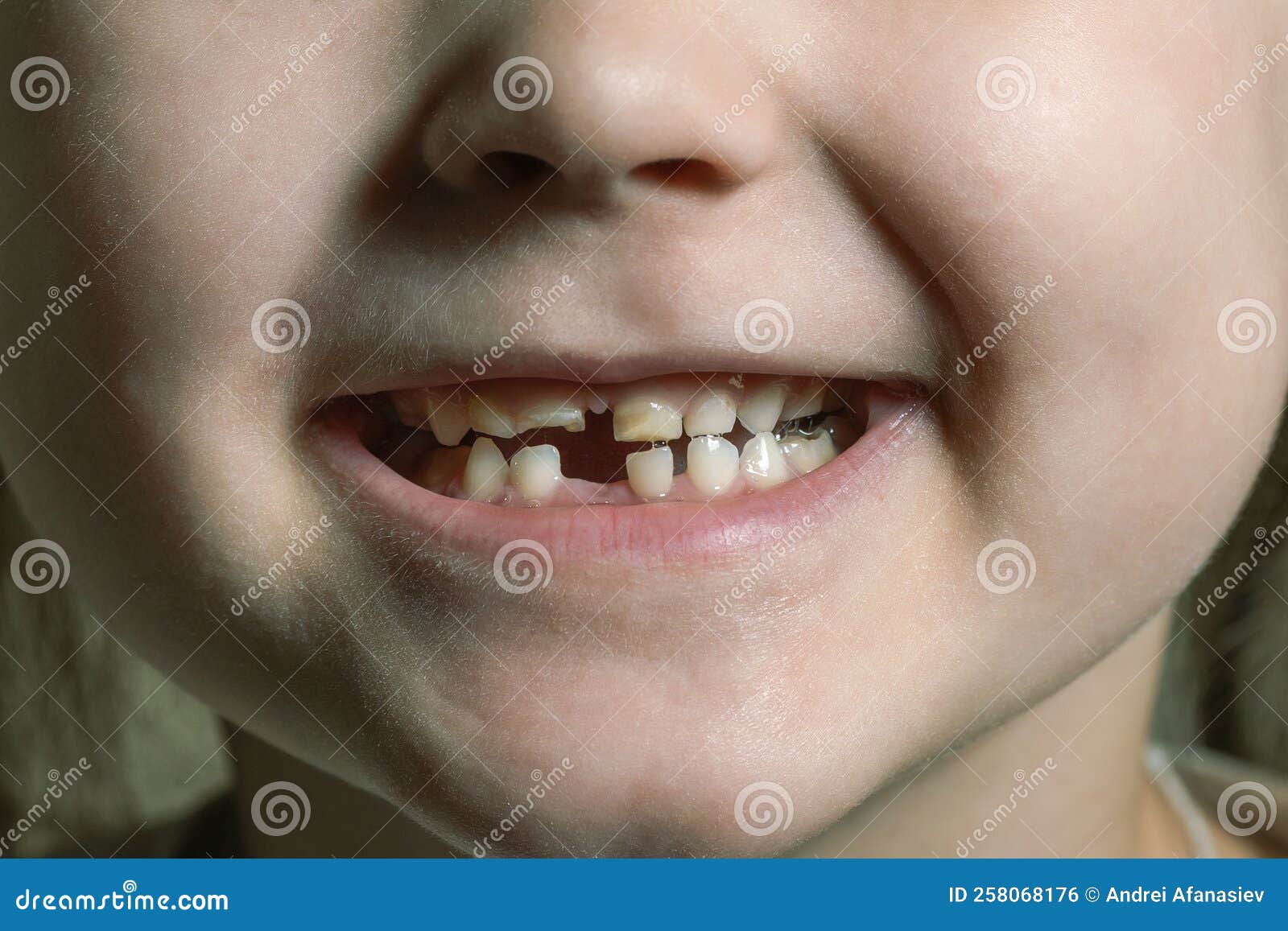 Children`s Mouth with Fallen and Broken Milk Teeth Stock Photo - Image ...