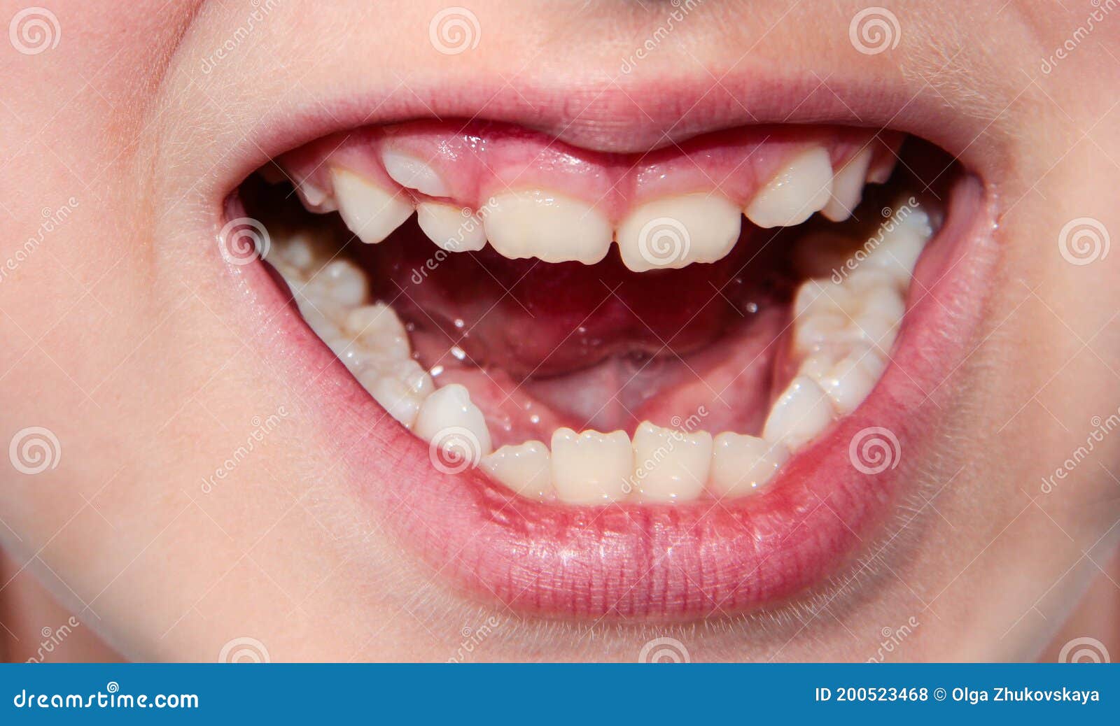 Children`s Teeth. the Molar Grows in the Second Row Stock Photo - Image ...