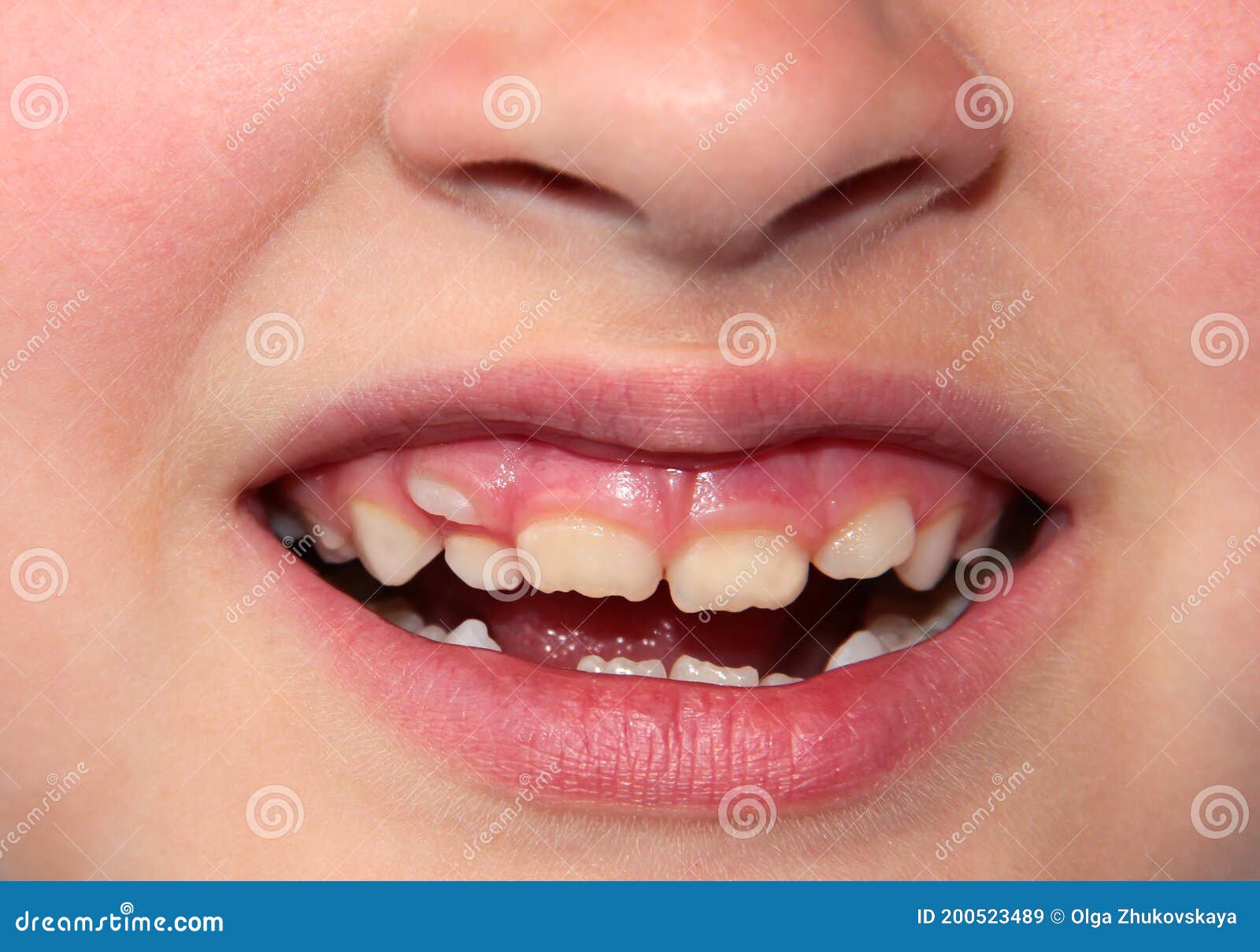 Children`s Teeth. the Molar Grows in the Second Row Stock Image - Image ...