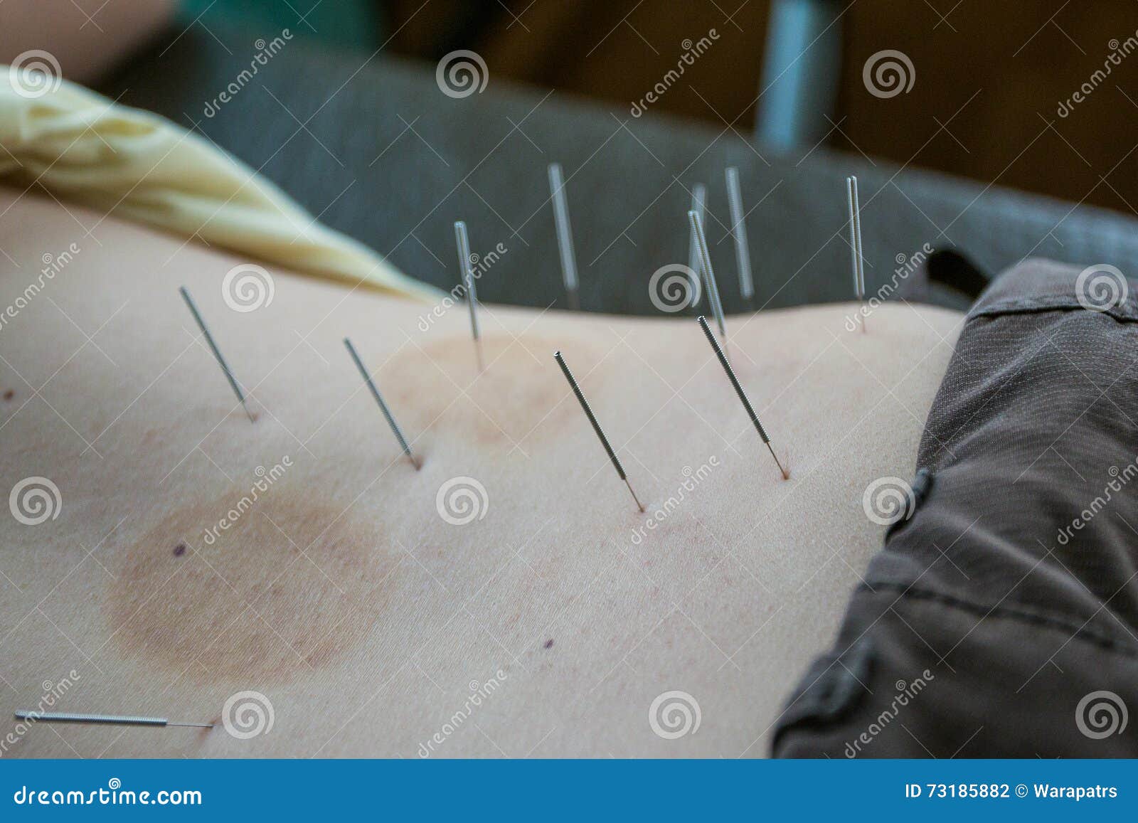 Chinese Acupuncture on Back for Treatment Stock Photo - Image of health ...