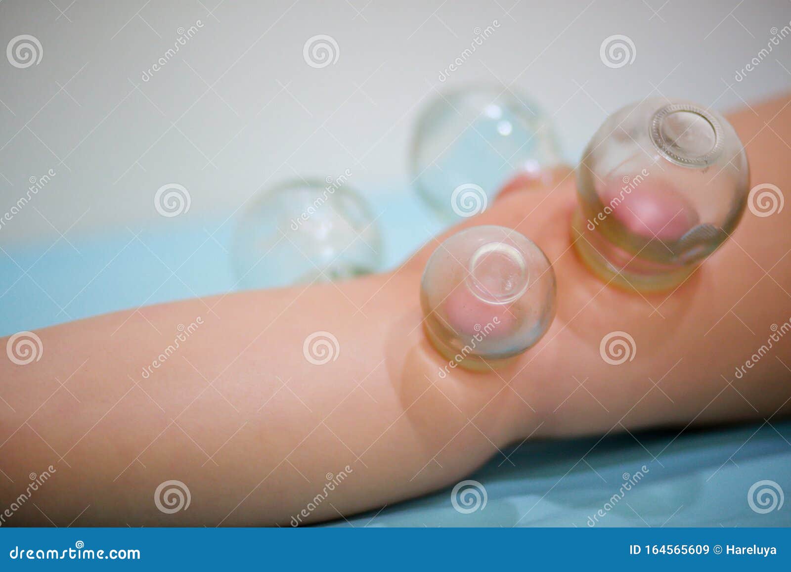 Chinese Medicine Science is a Method of Treatment Using Cupping. Stock ...
