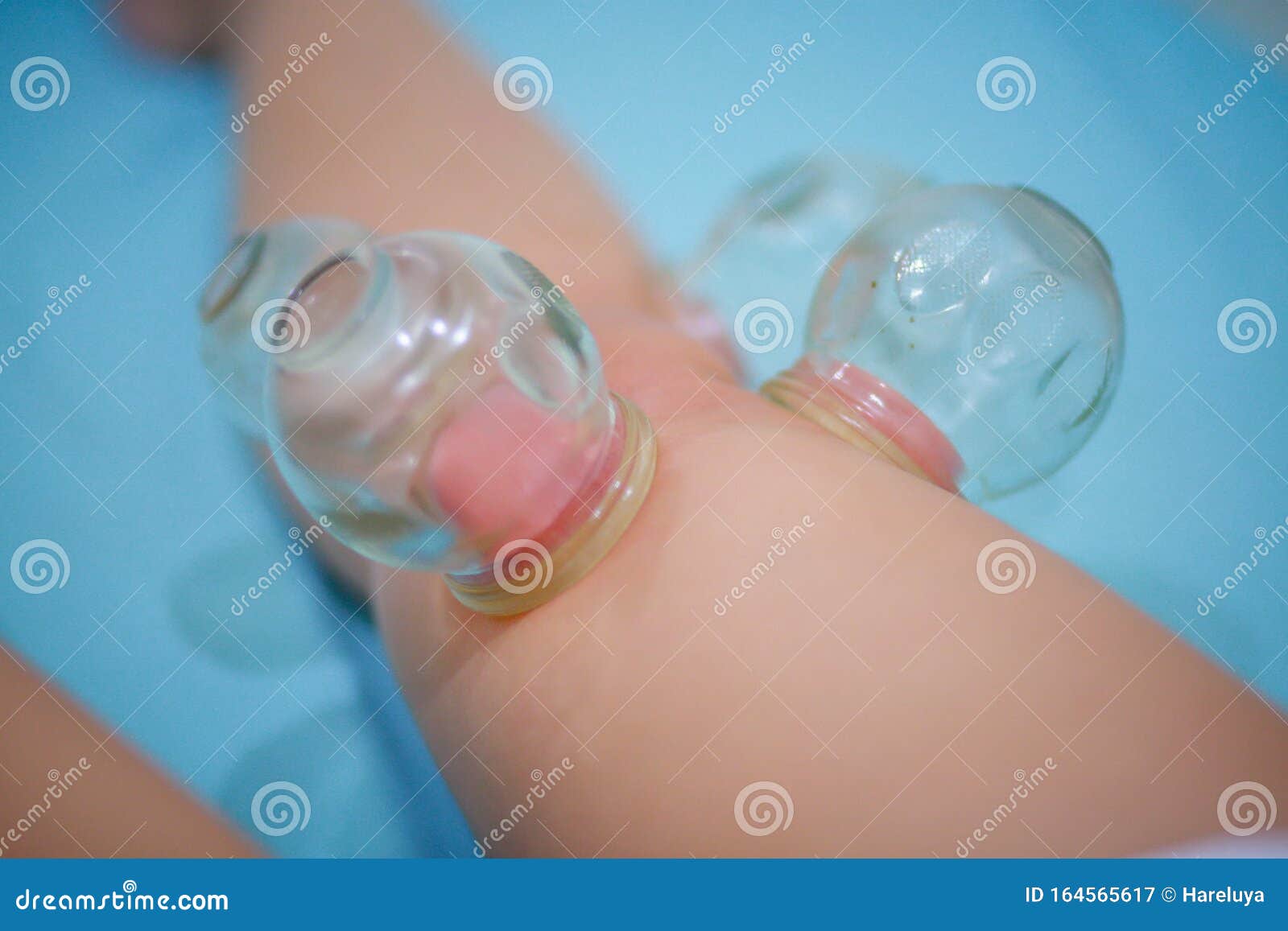 Chinese Medicine Science is a Method of Treatment Using Cupping. Stock ...