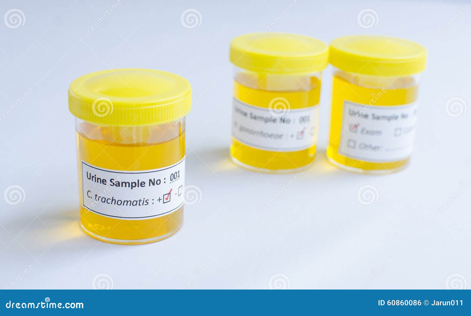 Chlamydia Trachomatis Positive Stock Photo - Image of sexually, care ...