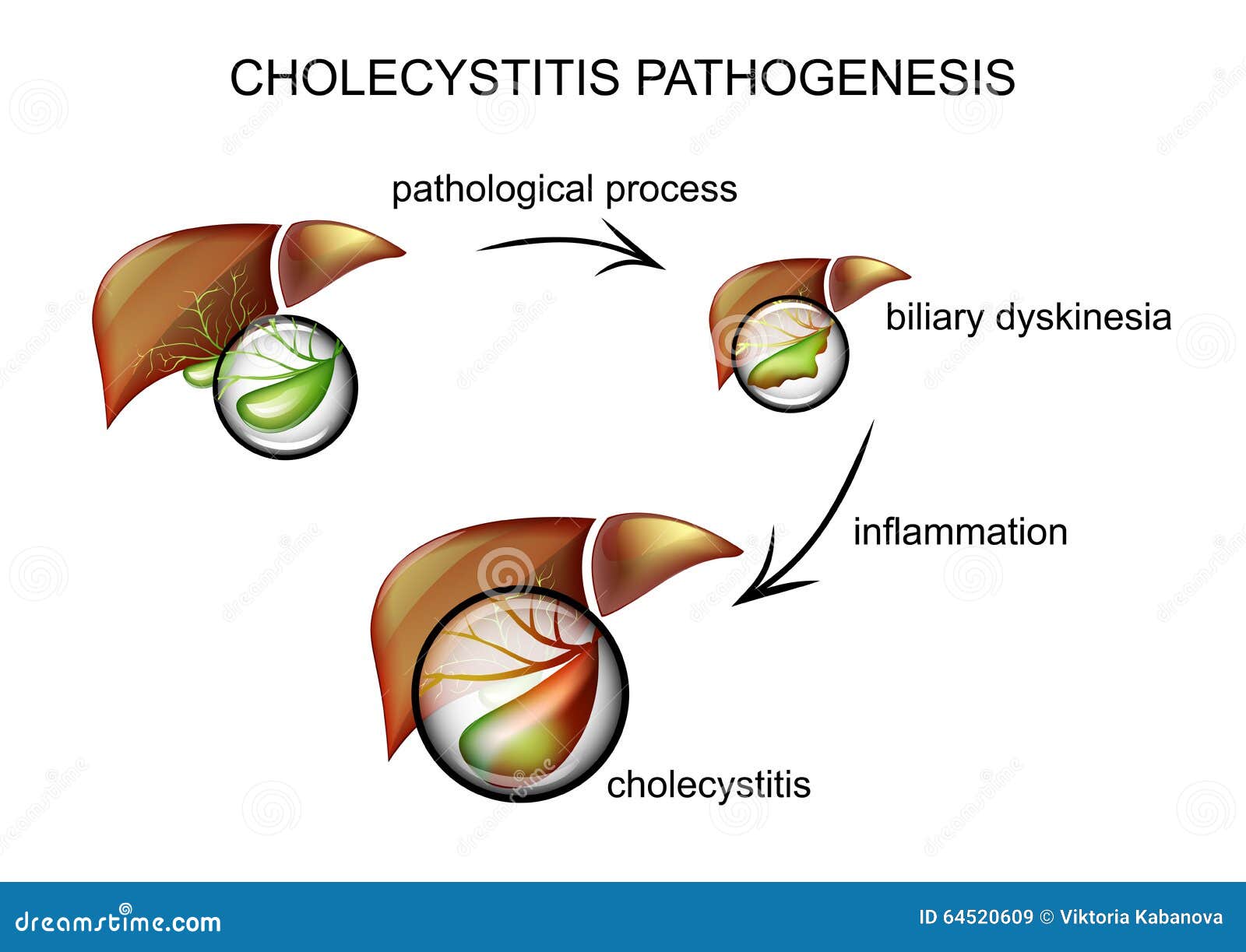 Cholecystitispathogenese Pathogenese Vektor Abbildung - Illustration ...