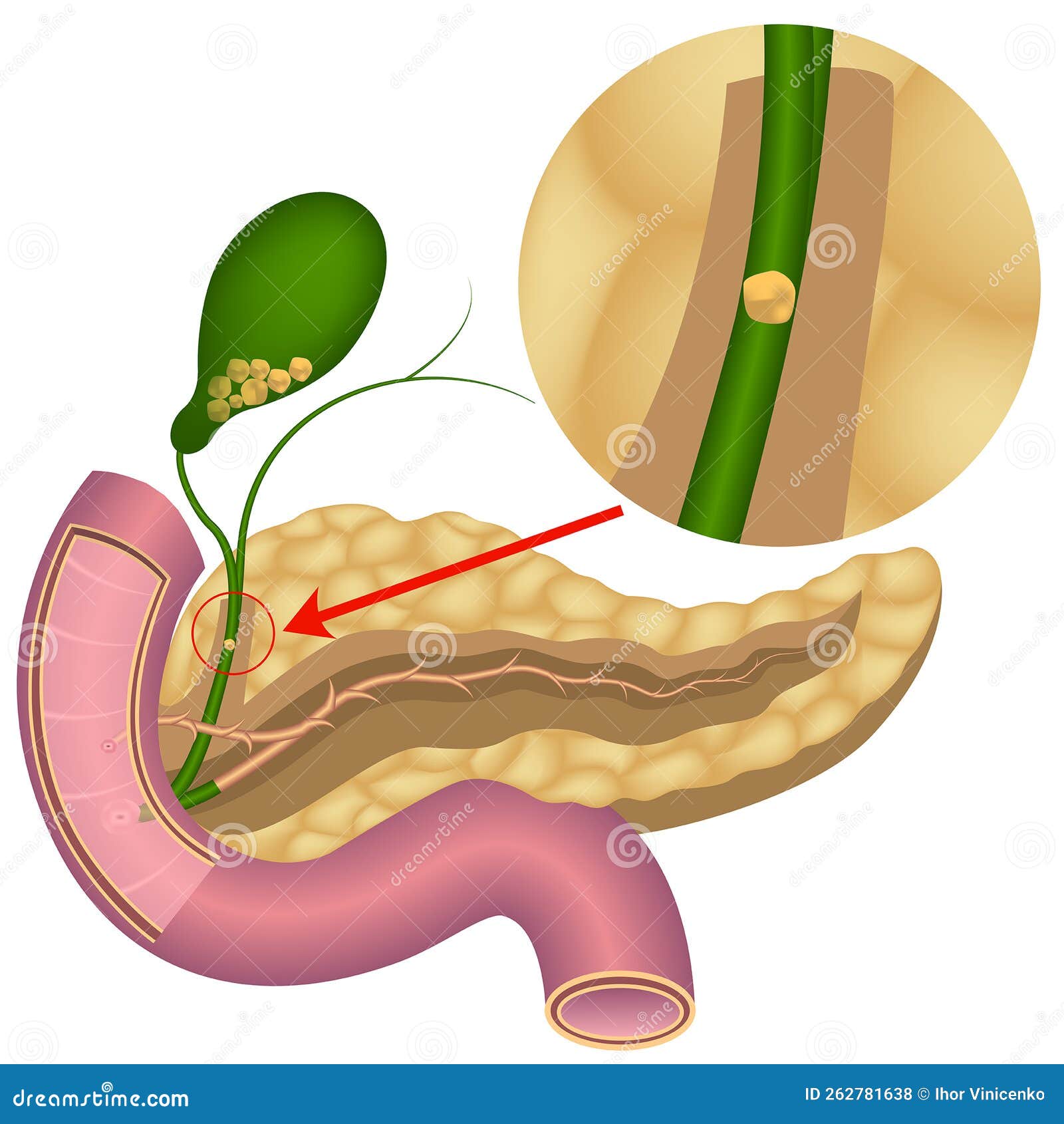 Cholelithiasis. Formations In The Gallbladder. Blockage Of The Bile ...