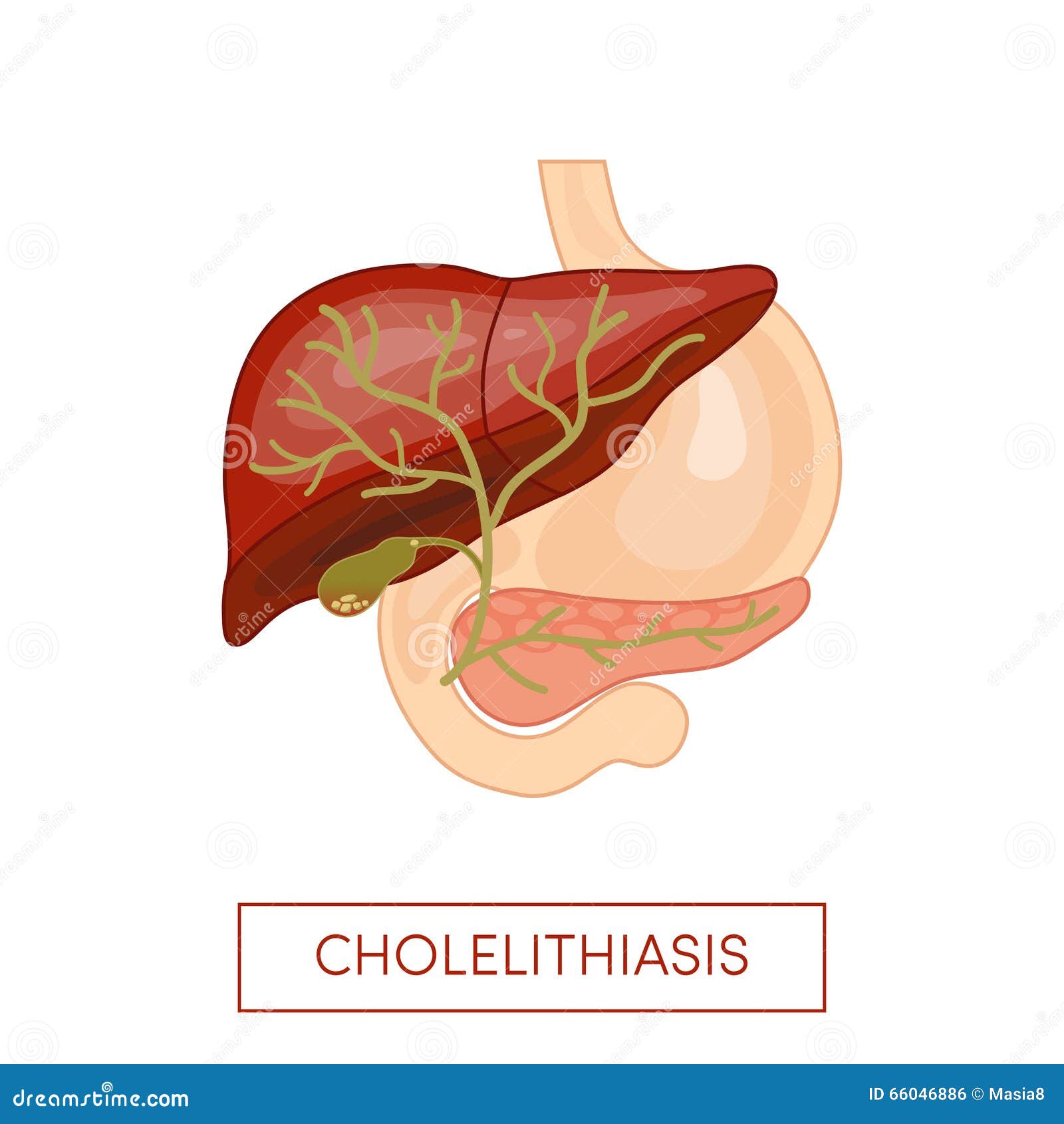 Cholelithiasis - Gallstensjukdom Stock Illustrationer - Illustration av ...