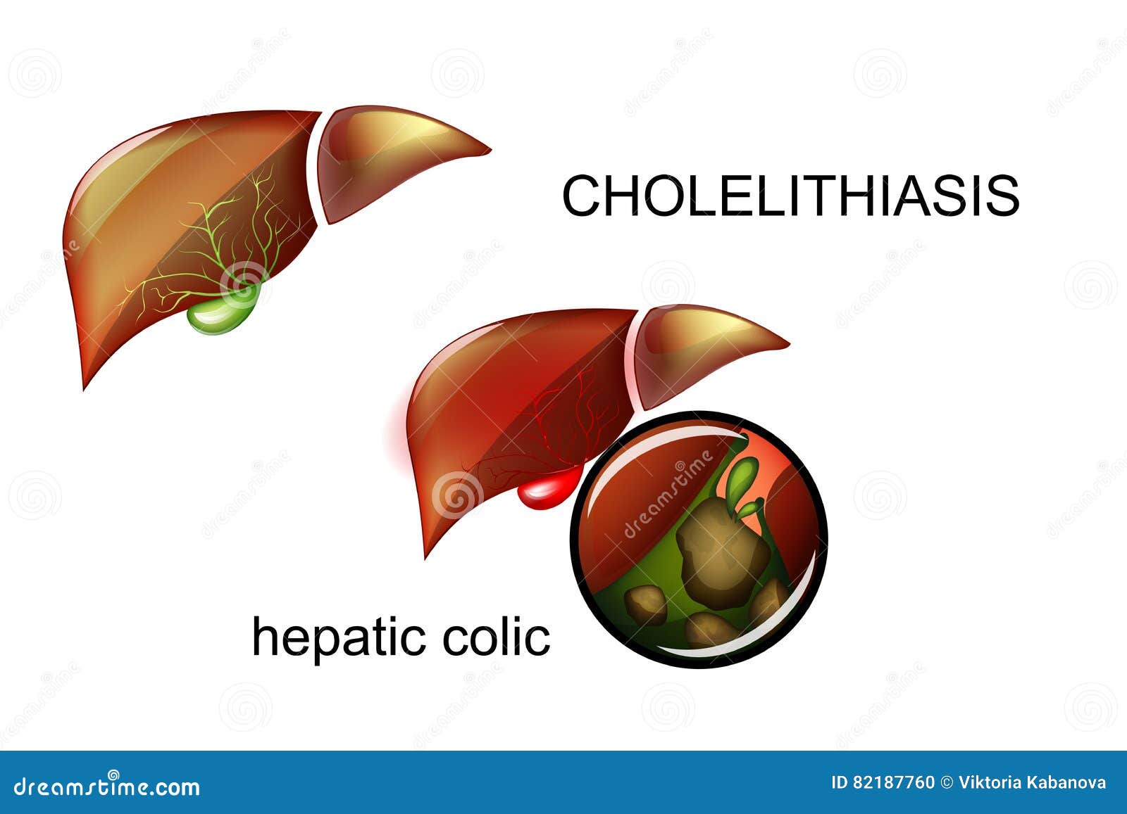Stones In The Gallbladder Vector Illustration | CartoonDealer.com #82590460