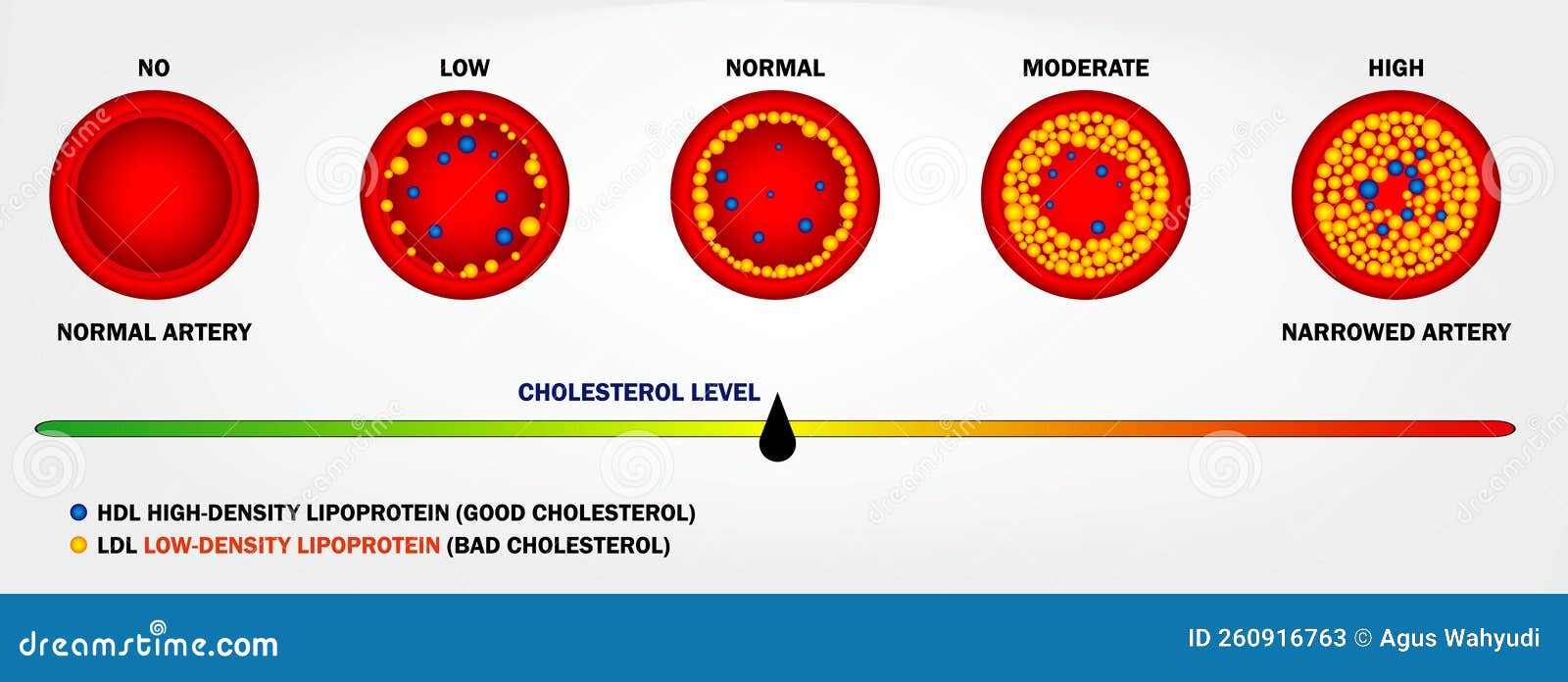Realistic Type of Cholesterol in Artery Isolated. Eps Vector. Stock ...