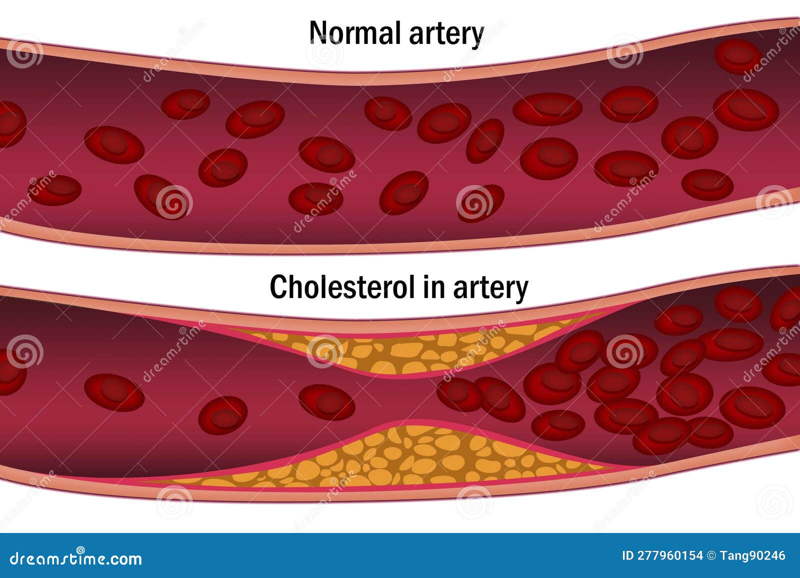 Cholesterol in Artery. Medical Concep Stock Illustration - Illustration ...