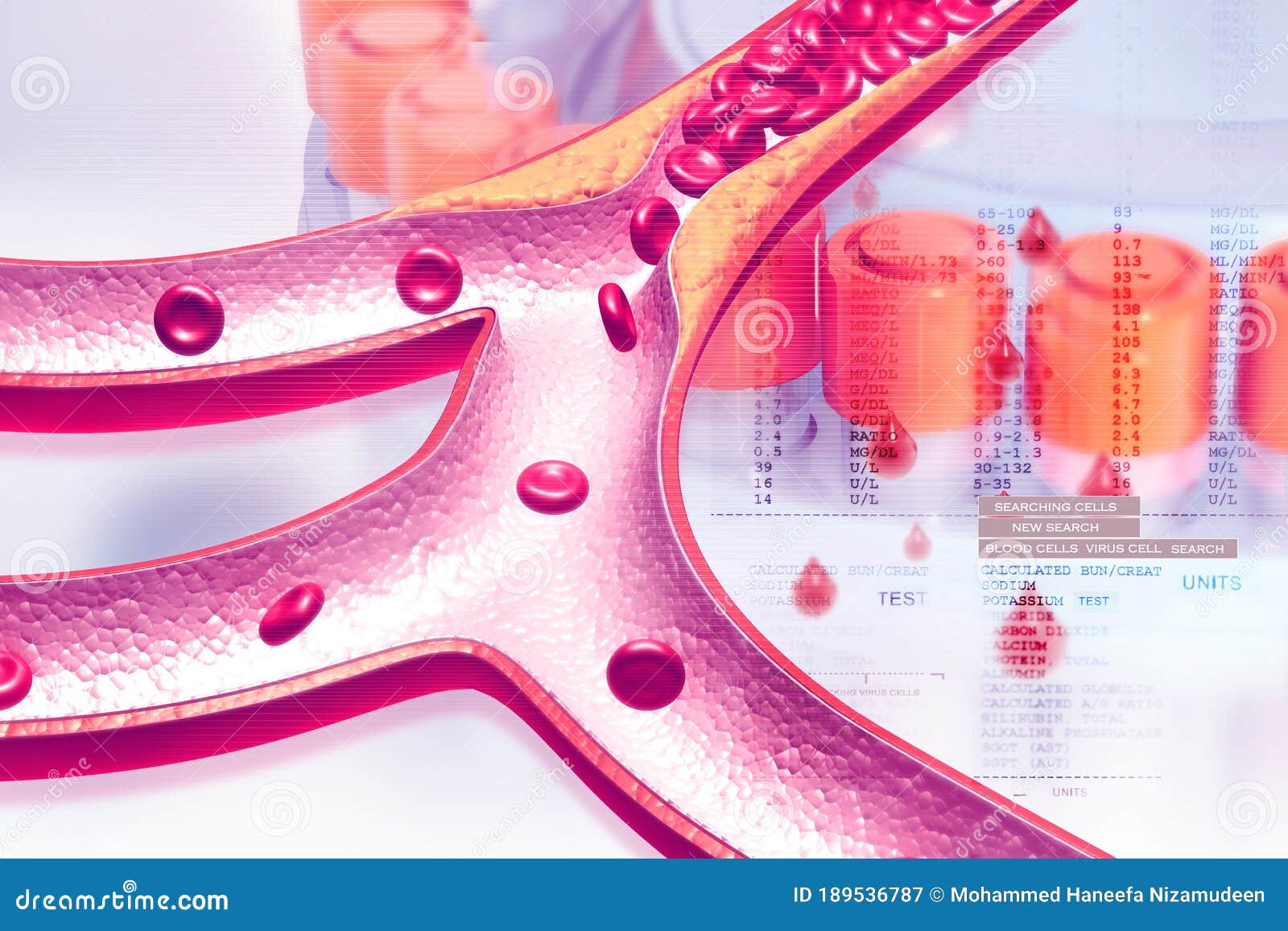Cholesterol Plaque in Artery Stock Illustration - Illustration of ...