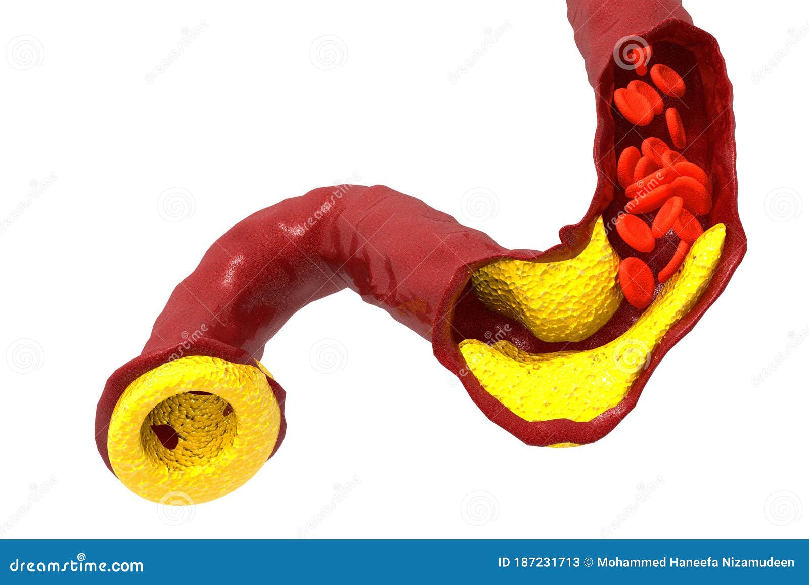 Cholesterol Plaque in Artery Stock Illustration - Illustration of ...