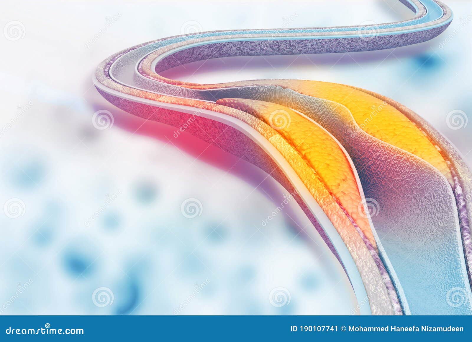 Cholesterol Plaque in Artery Stock Illustration - Illustration of care ...