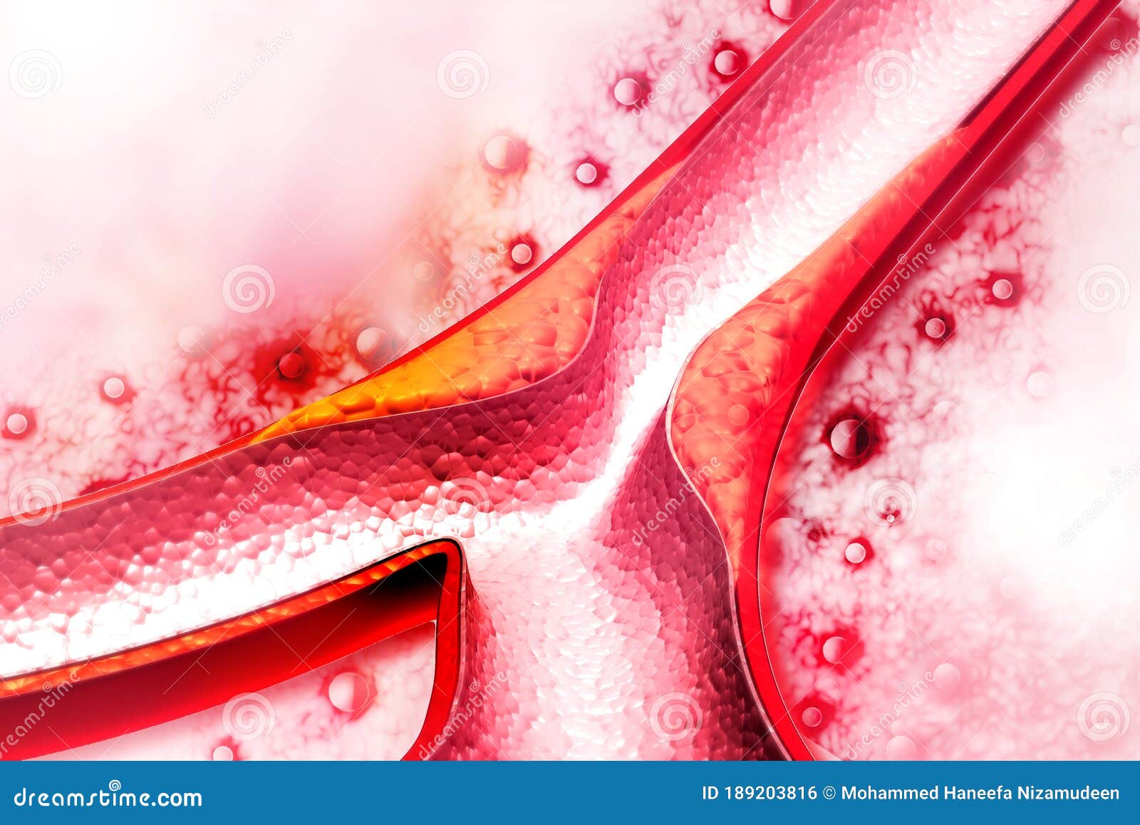Cholesterol Plaque in Artery Stock Illustration - Illustration of ...