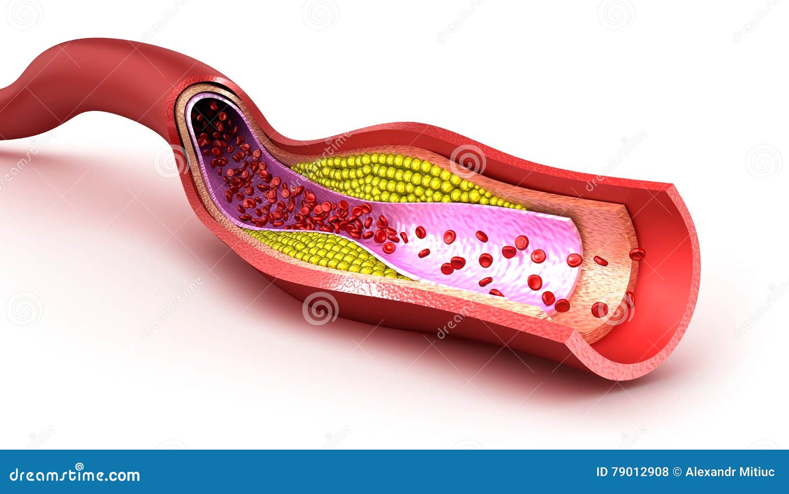 Cholesterol Plaque in Blood Vessel Stock Illustration - Illustration of ...