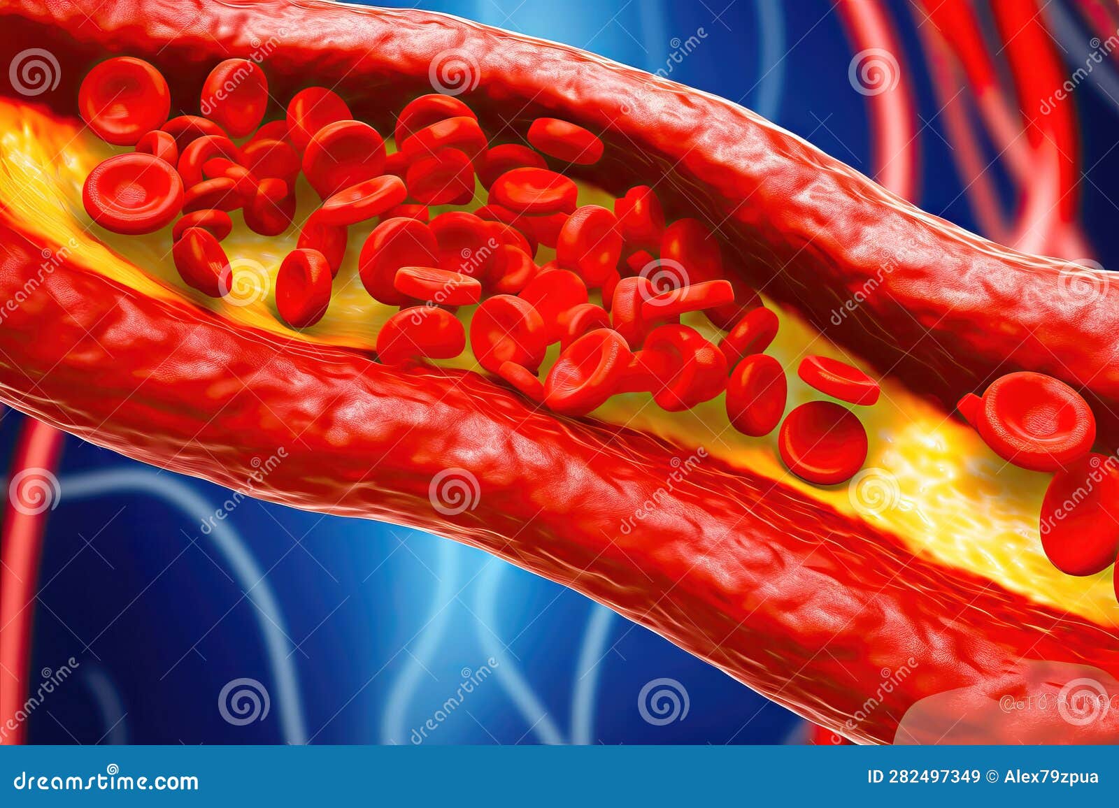 Cholesterol Plaque in Vein: Medical Condition Visual - Generative AI ...