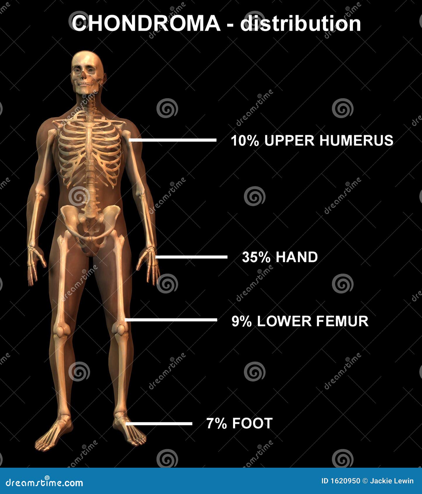 Chondroma stock illustration. Illustration of femur, bone - 1620950