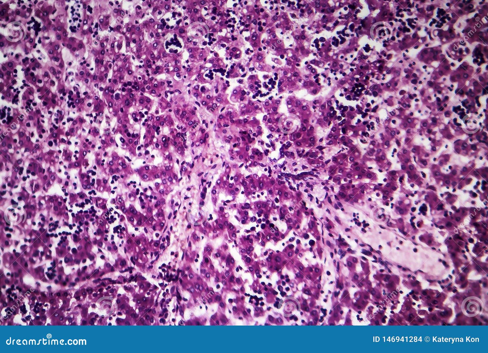 Chronic Active Hepatitis, Light Micrograph Stock Illustration ...