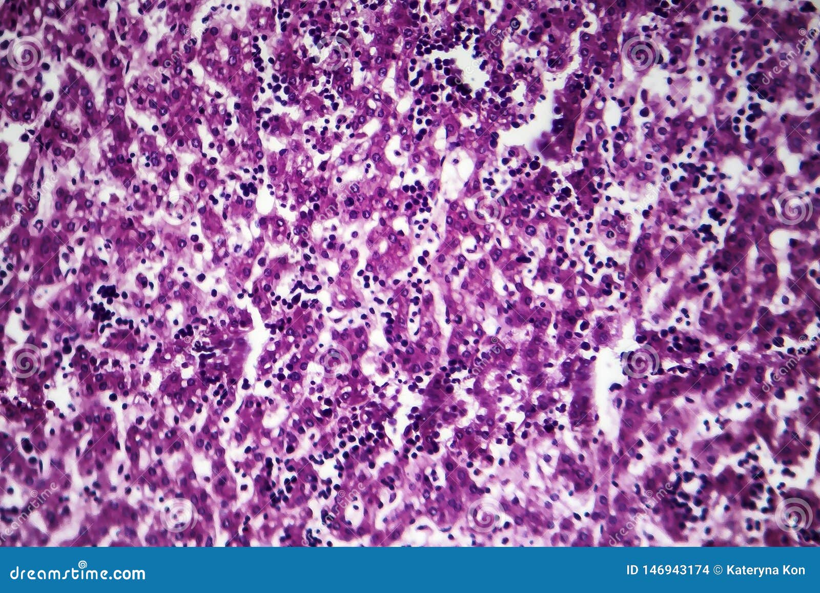 Chronic Active Hepatitis, Light Micrograph Stock Illustration ...