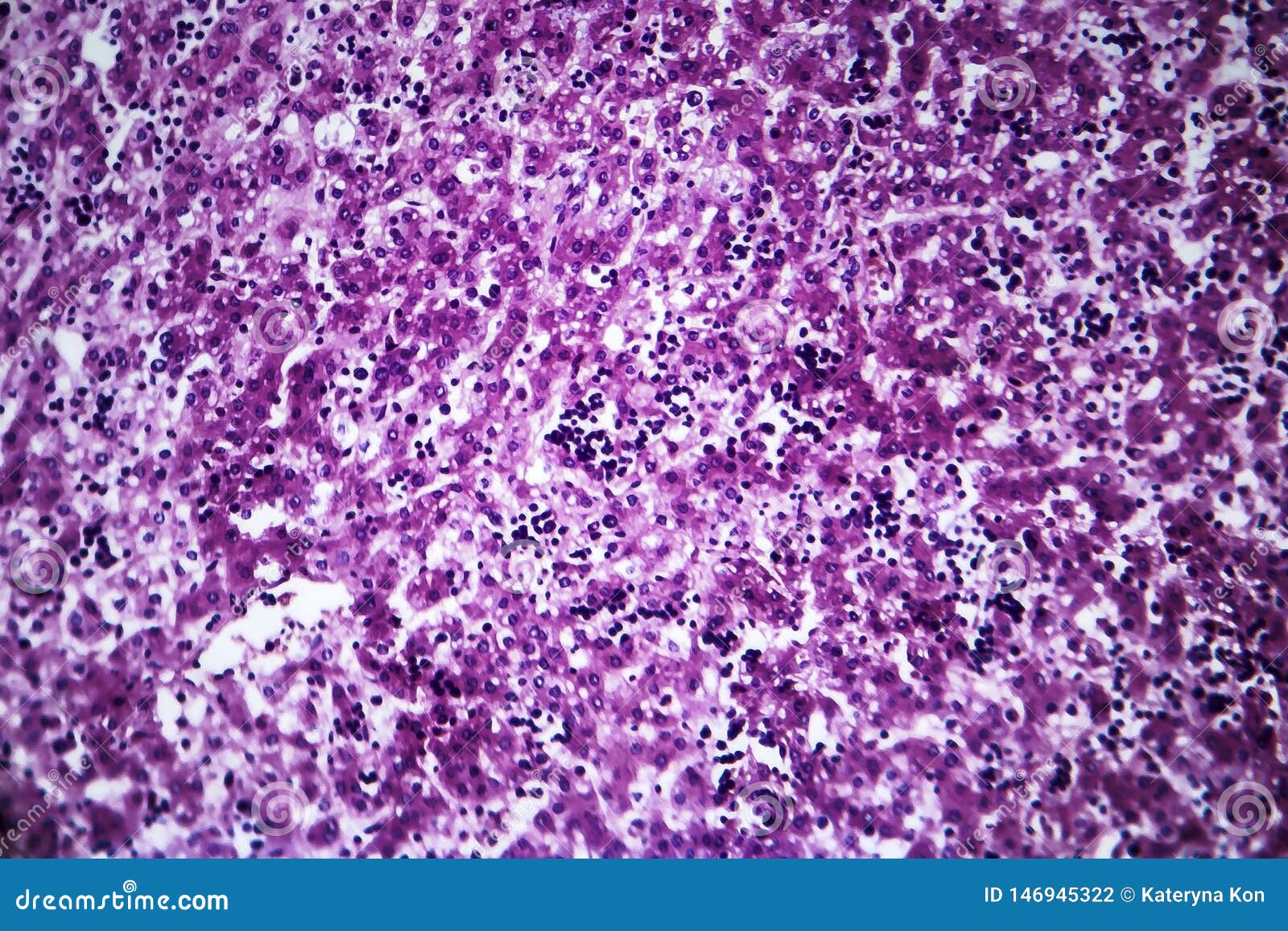 Chronic Active Hepatitis, Light Micrograph Stock Illustration ...