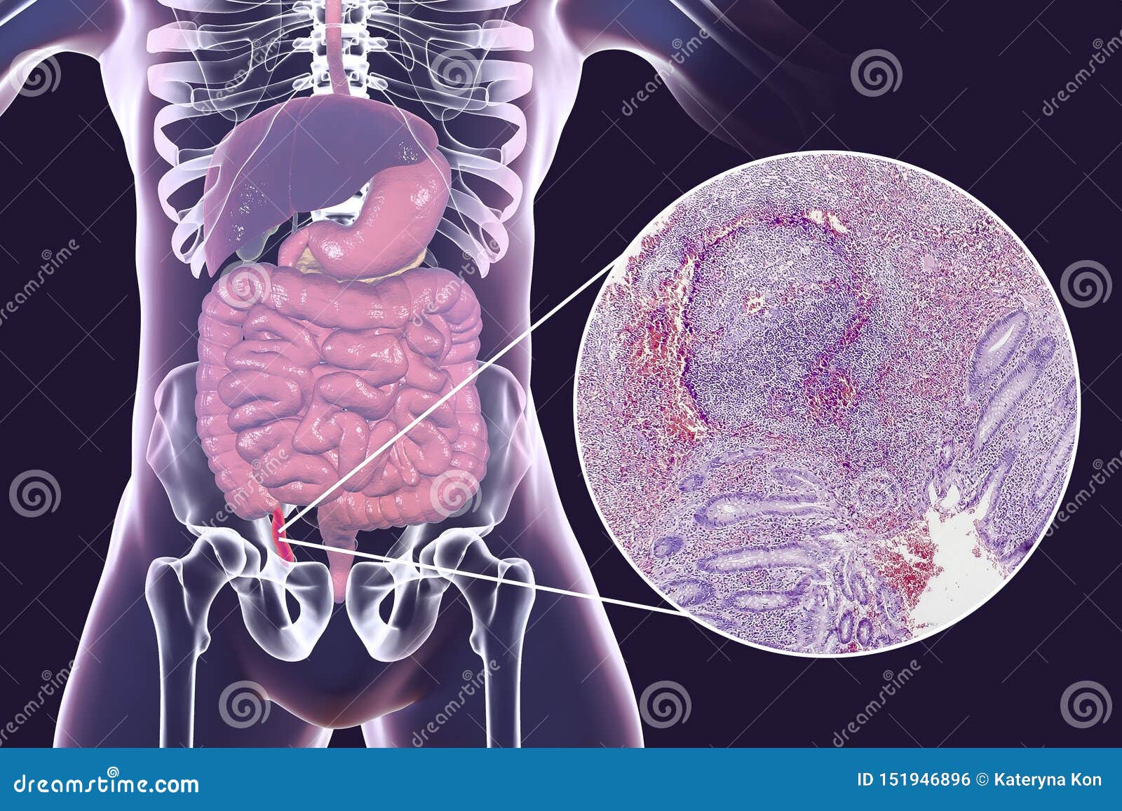 Chronic Appendicitis, Illustration and Light Micrograph Stock ...