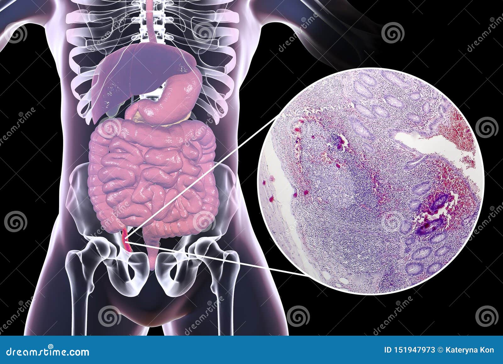 Chronic Appendicitis, Illustration and Light Micrograph Stock ...