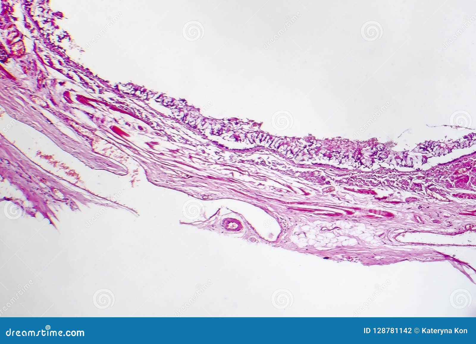 Chronic Bronchitis Histology
